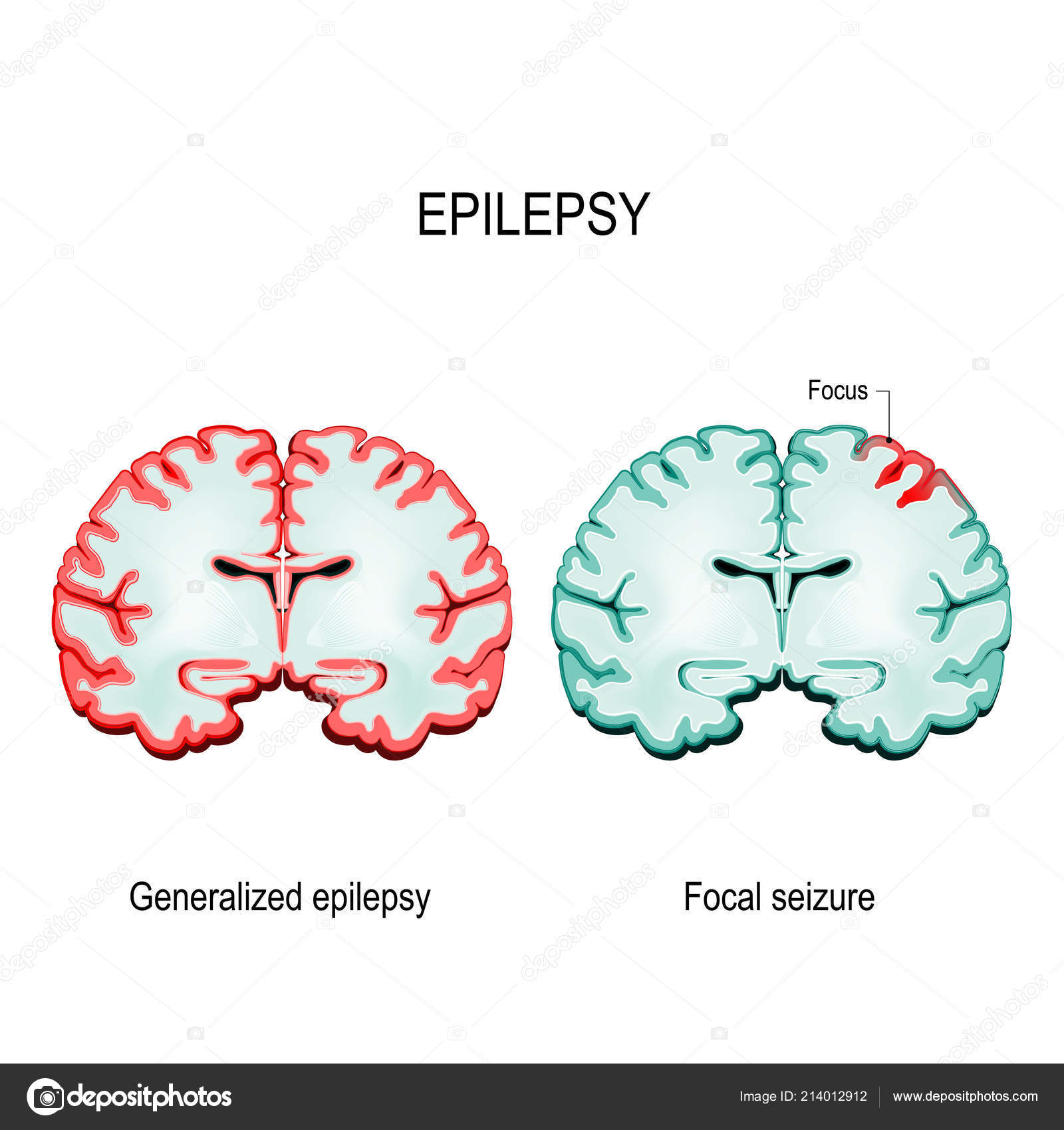 Epilepsy Brain Diagram