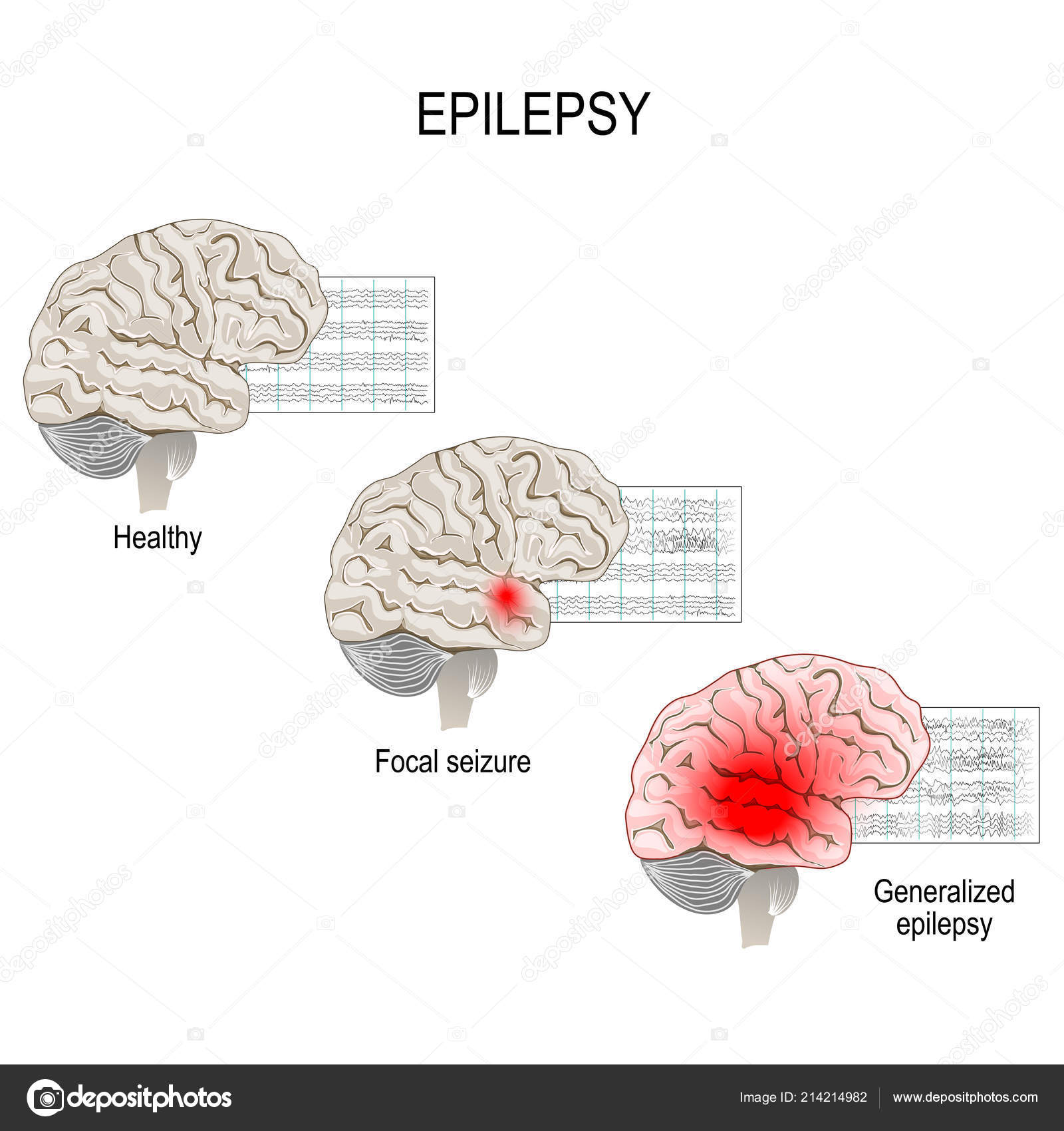 Epilepsy Brain Diagram