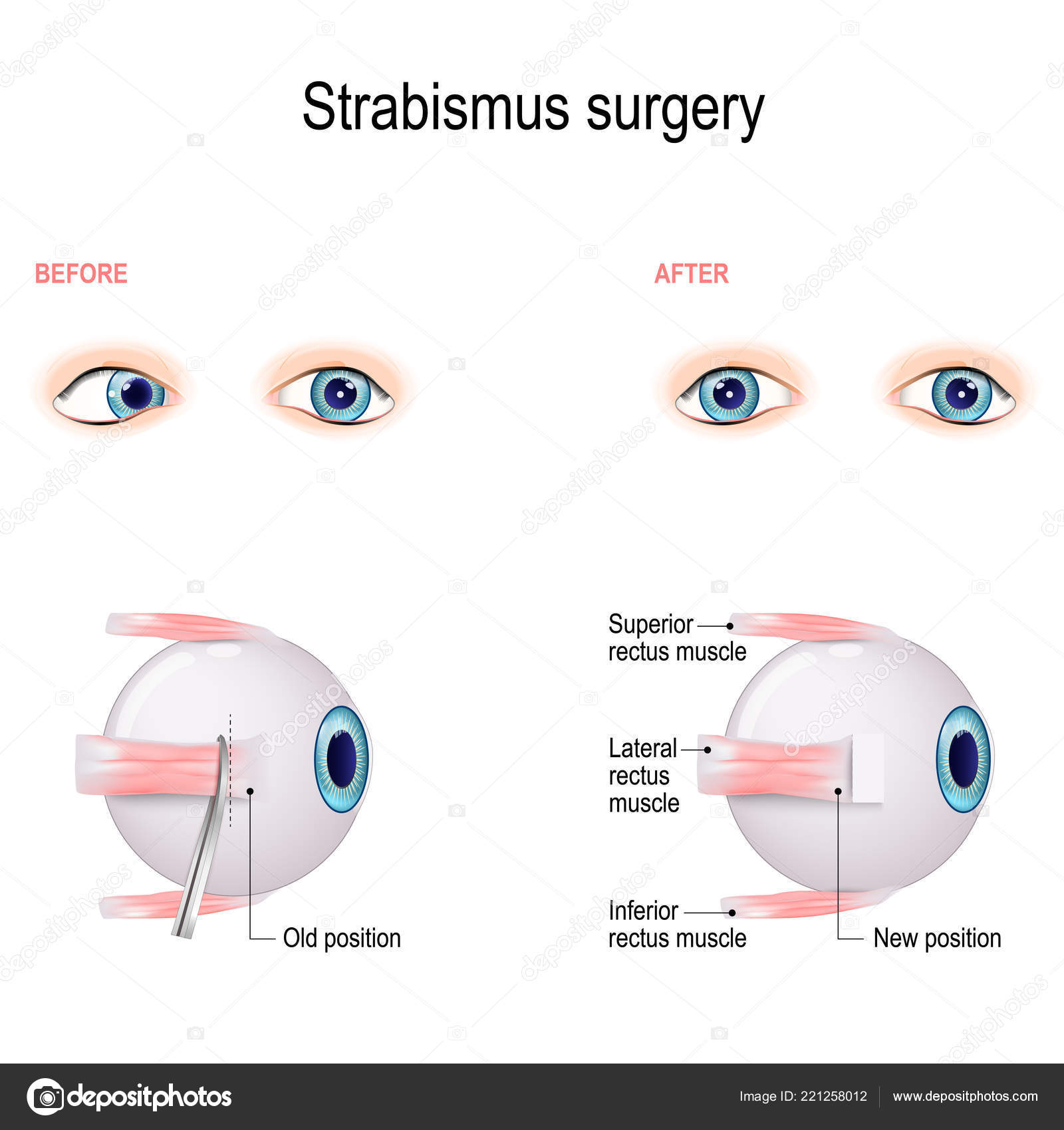 Strabismus Surgery Eye Muscle Recession Extraocular Muscle Anatomy ...