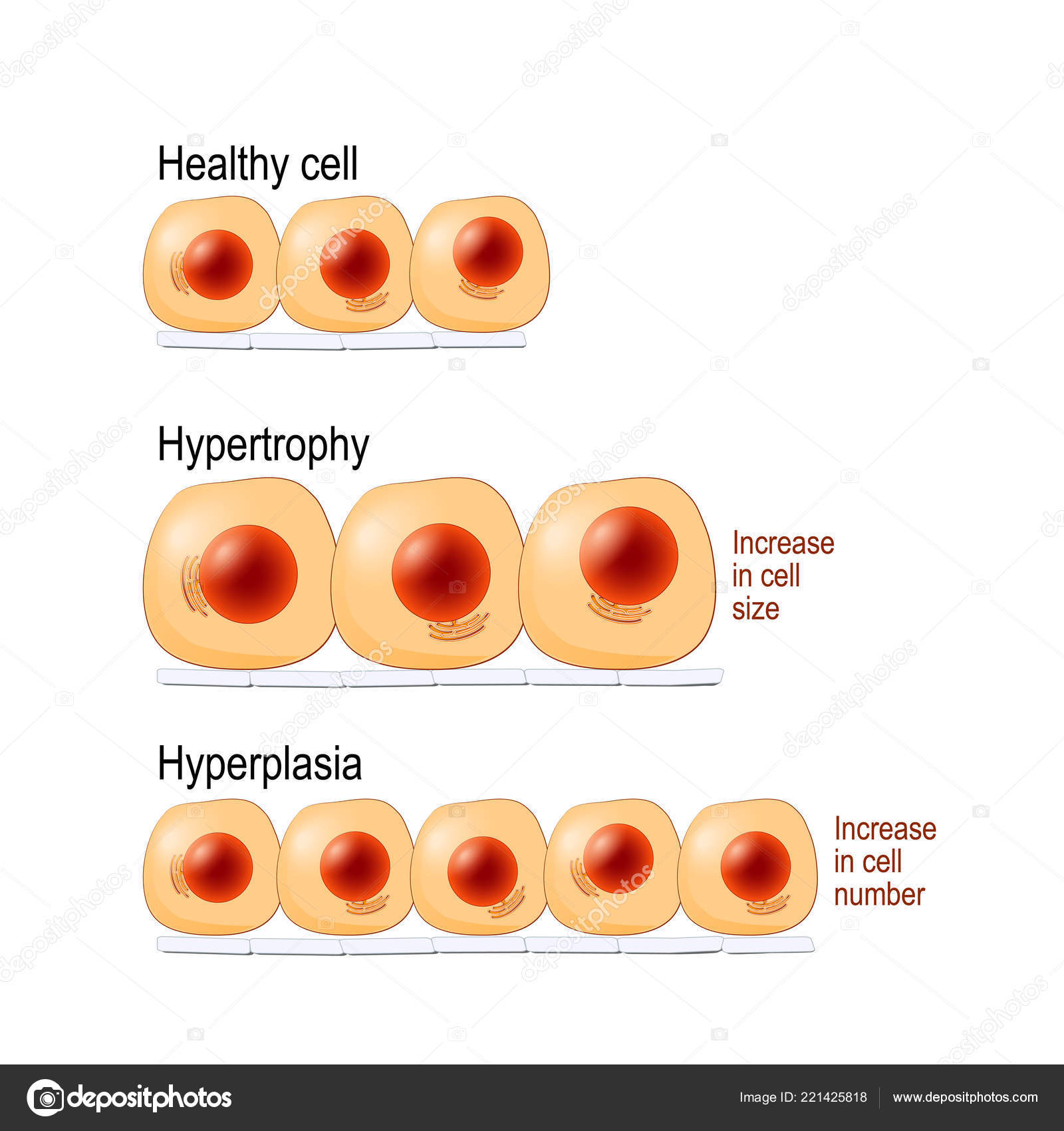Normal Cells Hypertrophy Increase Cell Size Hyperplasia Results ... Normal Cells Hypertrophy Increase Cell Size Hyperplasia Results ...