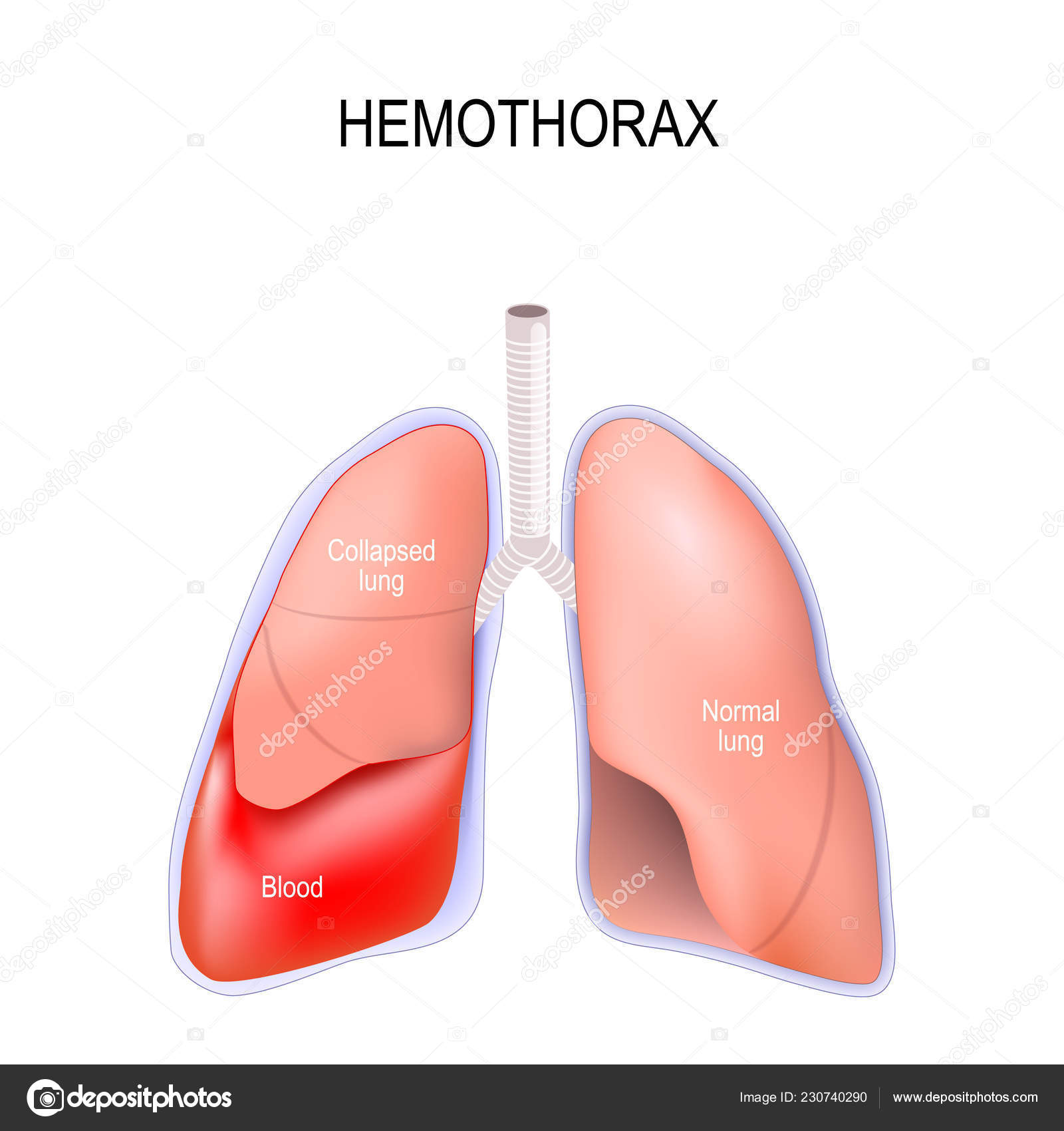 Hemothorax입니다 축소는 사이의 공간에 혈액의 비정상적인 컬렉션입니다 생물학 사용을 일러스트 Stock Vector by ...