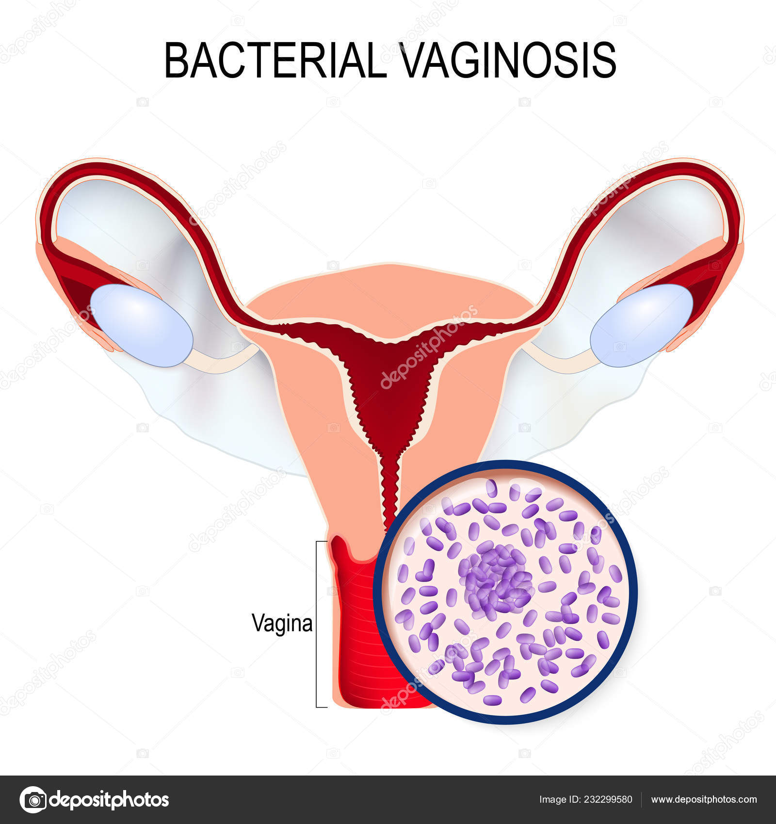 Bacterial Vaginosis Uterus Close Gardnerella Vaginalis Bacteria Caused Disease Sexually Stock ...