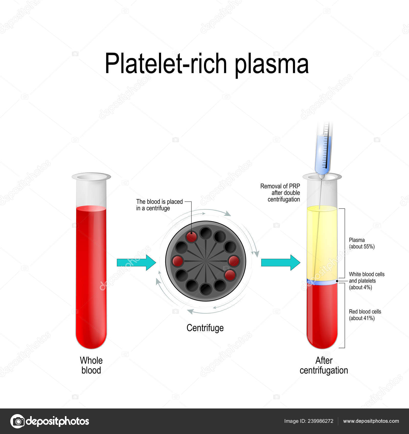 Platelet Rich Plasma Autologous Conditioned Plasma Concentrate Platelet ...