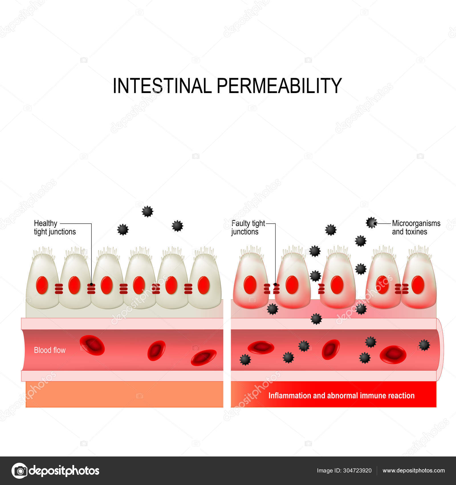 Leaky gut. Intestinal permeability Stock Vector Image by ©edesignua ...