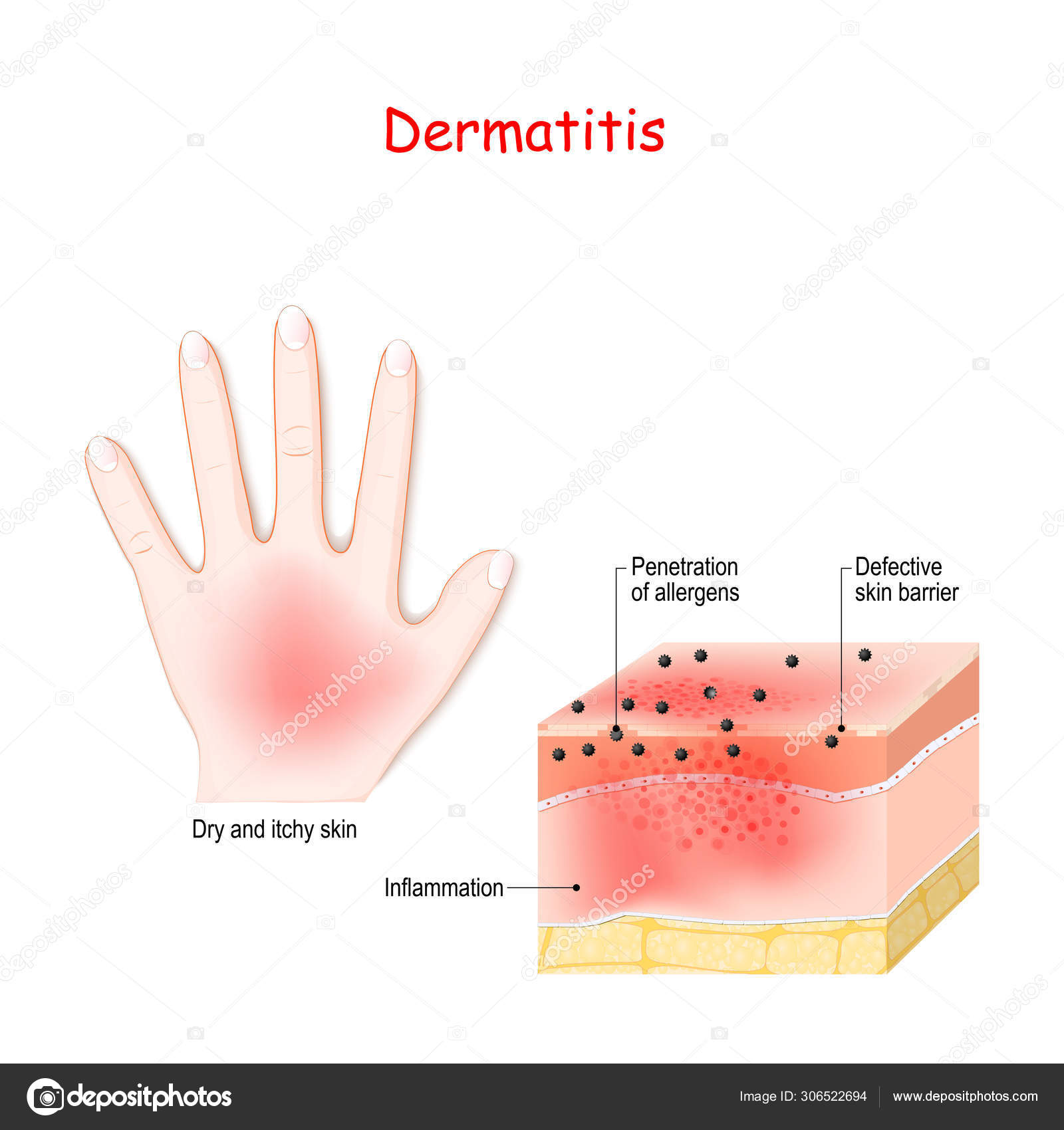 Dermatitis. Atopic eczema. Close-up of Cross-section of human s Stock ...