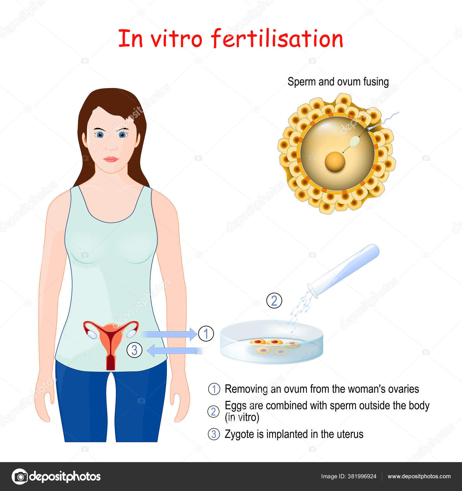 In Vitro Fertilization Diagram