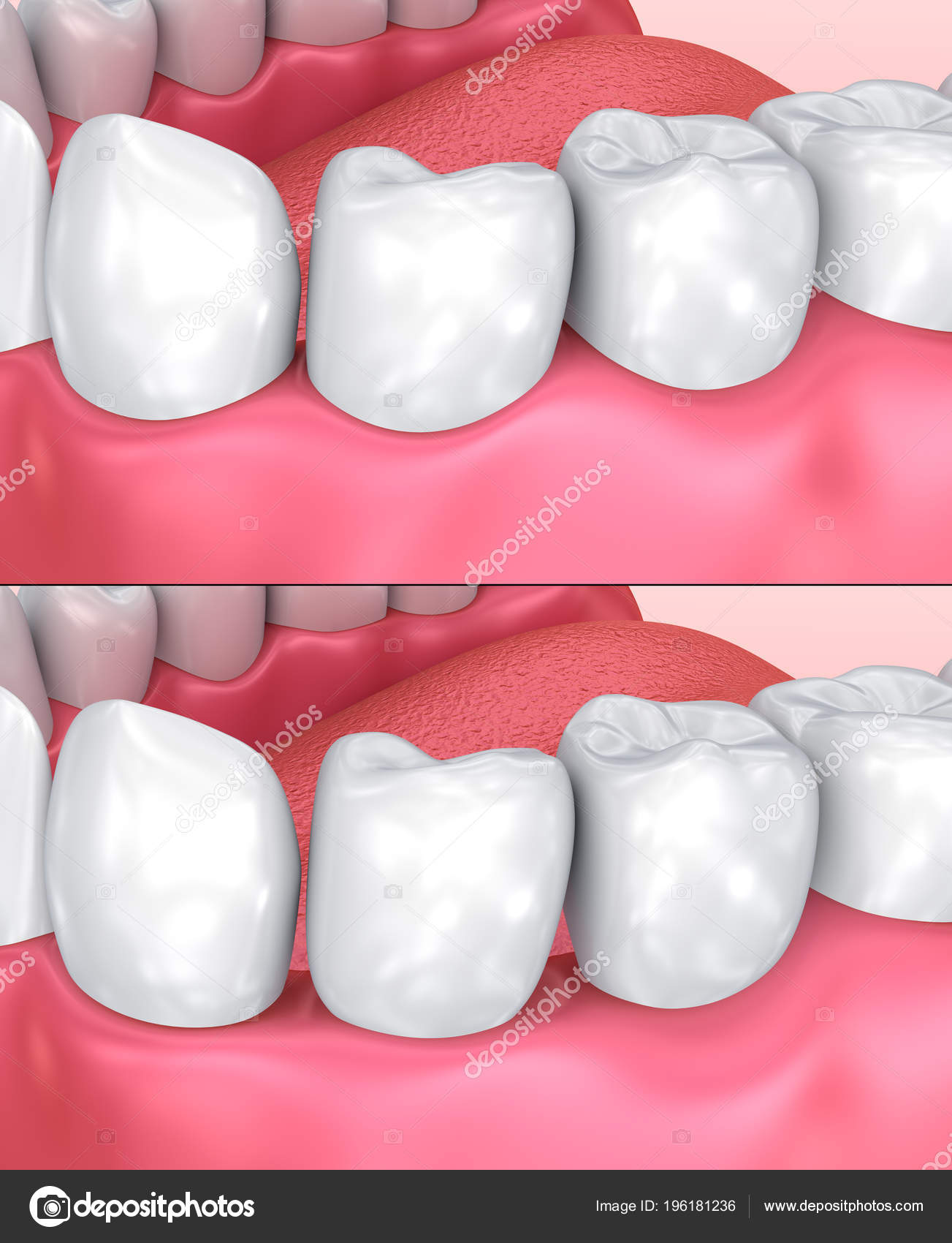 Normal Lowered Gum Medically Accurate Tooth Illustration Stock Photo by ...