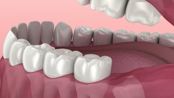 Wisdom Tooth Problem Medically Accurate Tooth Animation — Stock Video ...