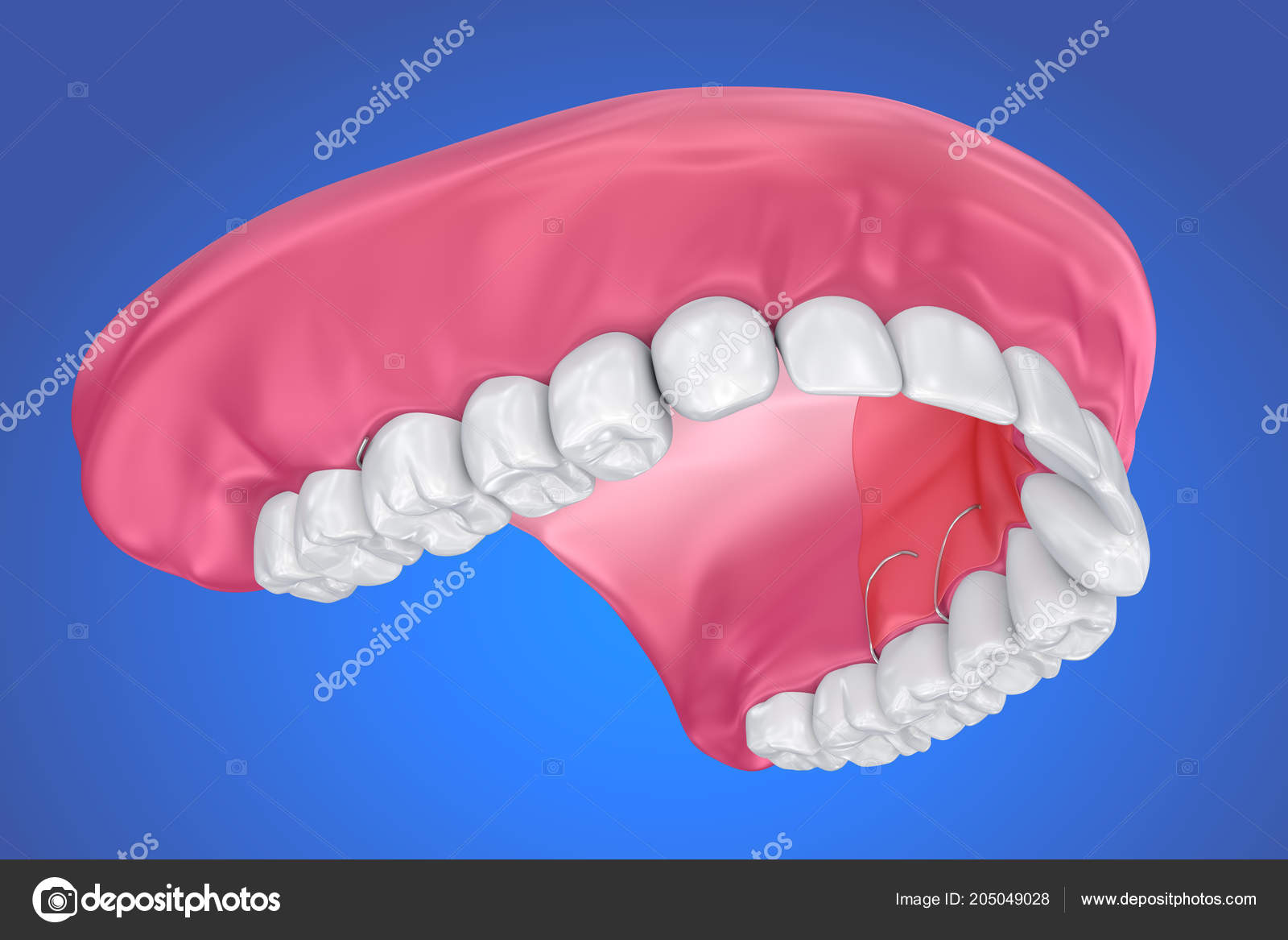 Single Missing Tooth Removable Partial Denture Illustration — Stock ...