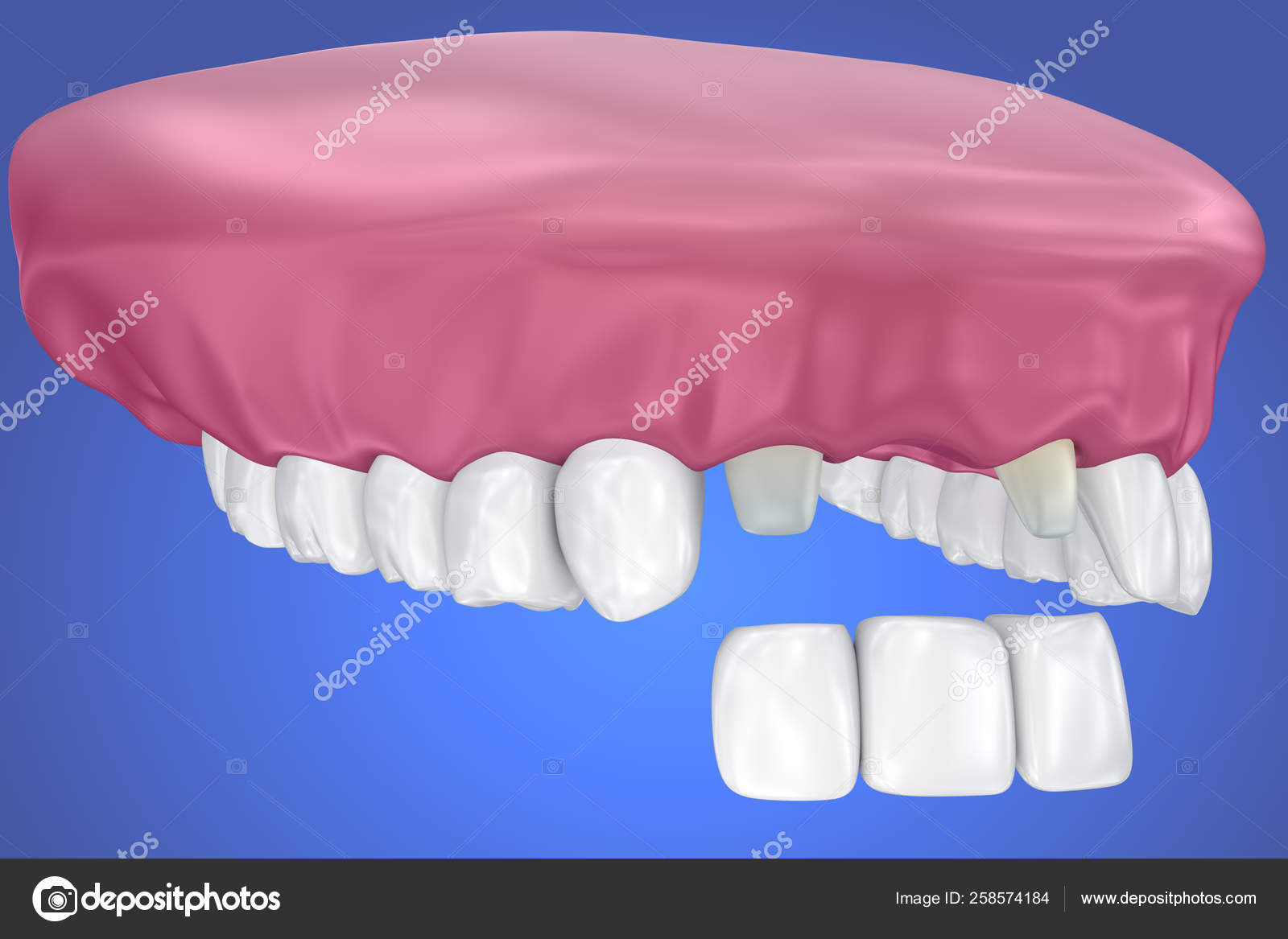 Tooth Supported Fixed Bridge Medically Accurate Illustration Stock ...