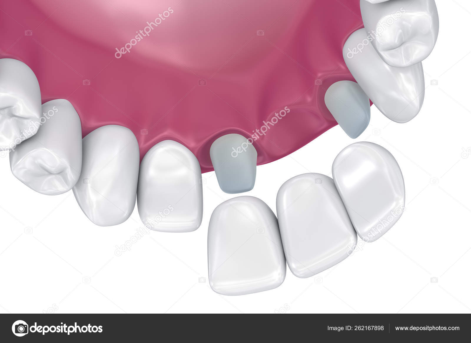 Tooth Supported Fixed Bridge Medically Accurate Illustration — Stock ...