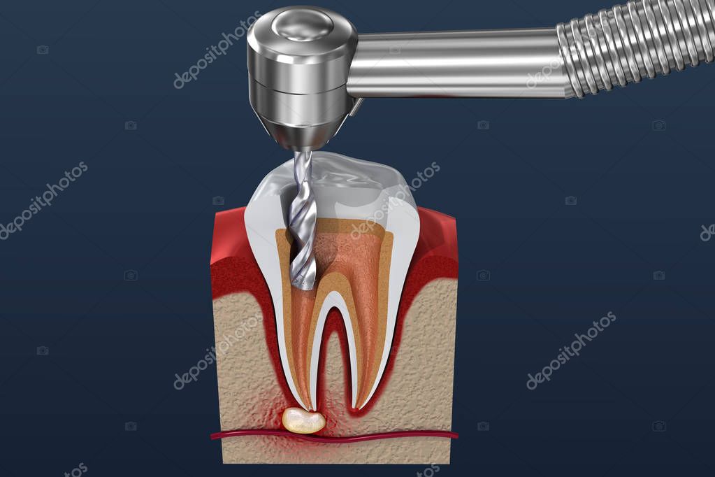 Proceso de tratamiento del canal radicular. Ilustración 3D 2023