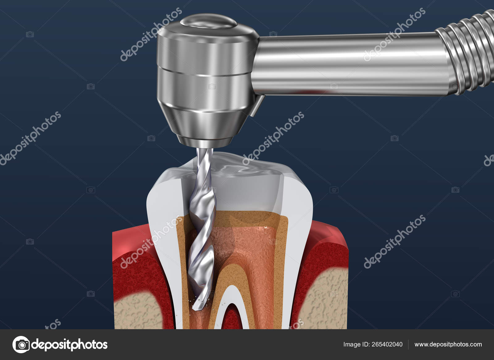 Root Canal Treatment Process Illustration ⬇ Stock Photo, Image by ...