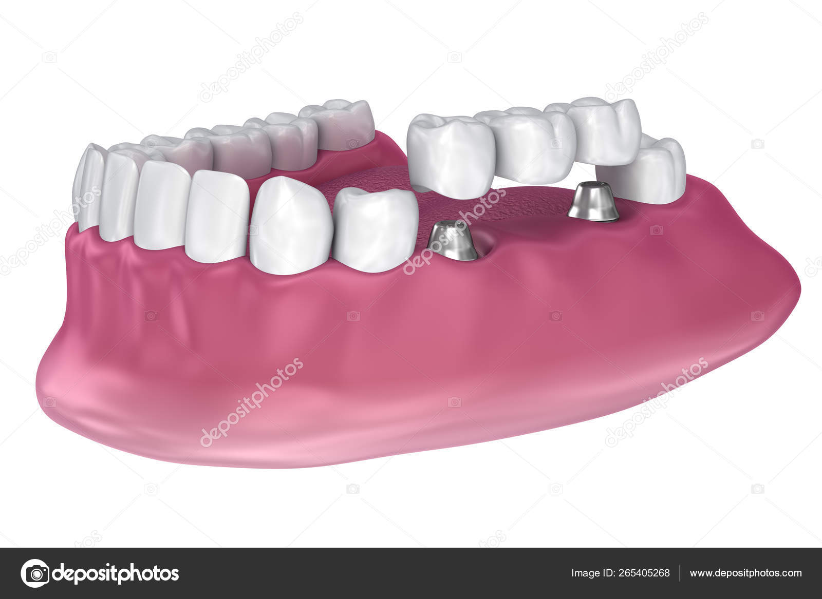 Implant Supported Fixed Bridge Transparent View Medically Accurate ...