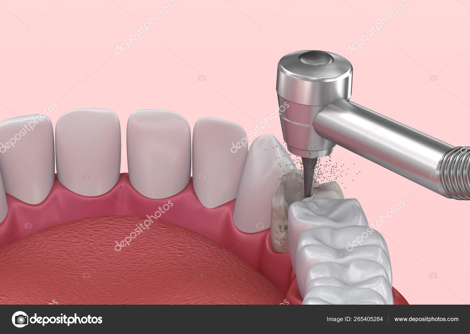 Removing Caries Medically Accurate Tooth Illustration Stock Photo by ...