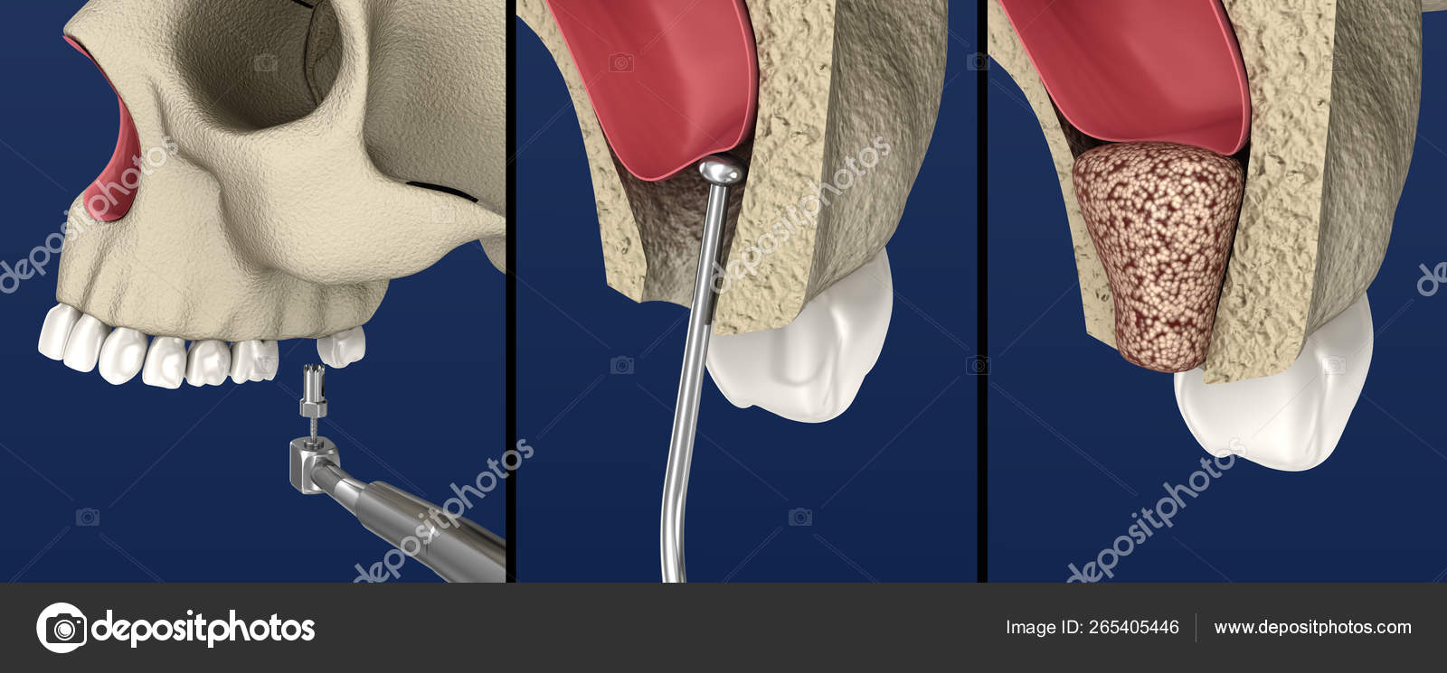 Sinus Lift Surgery Sinus Augmentation Illustration Stock Photo by ...