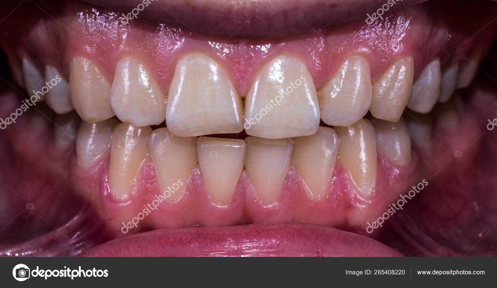 Healthy Human Teeth Normal Occlusion Frontal View Stock Photo by ...