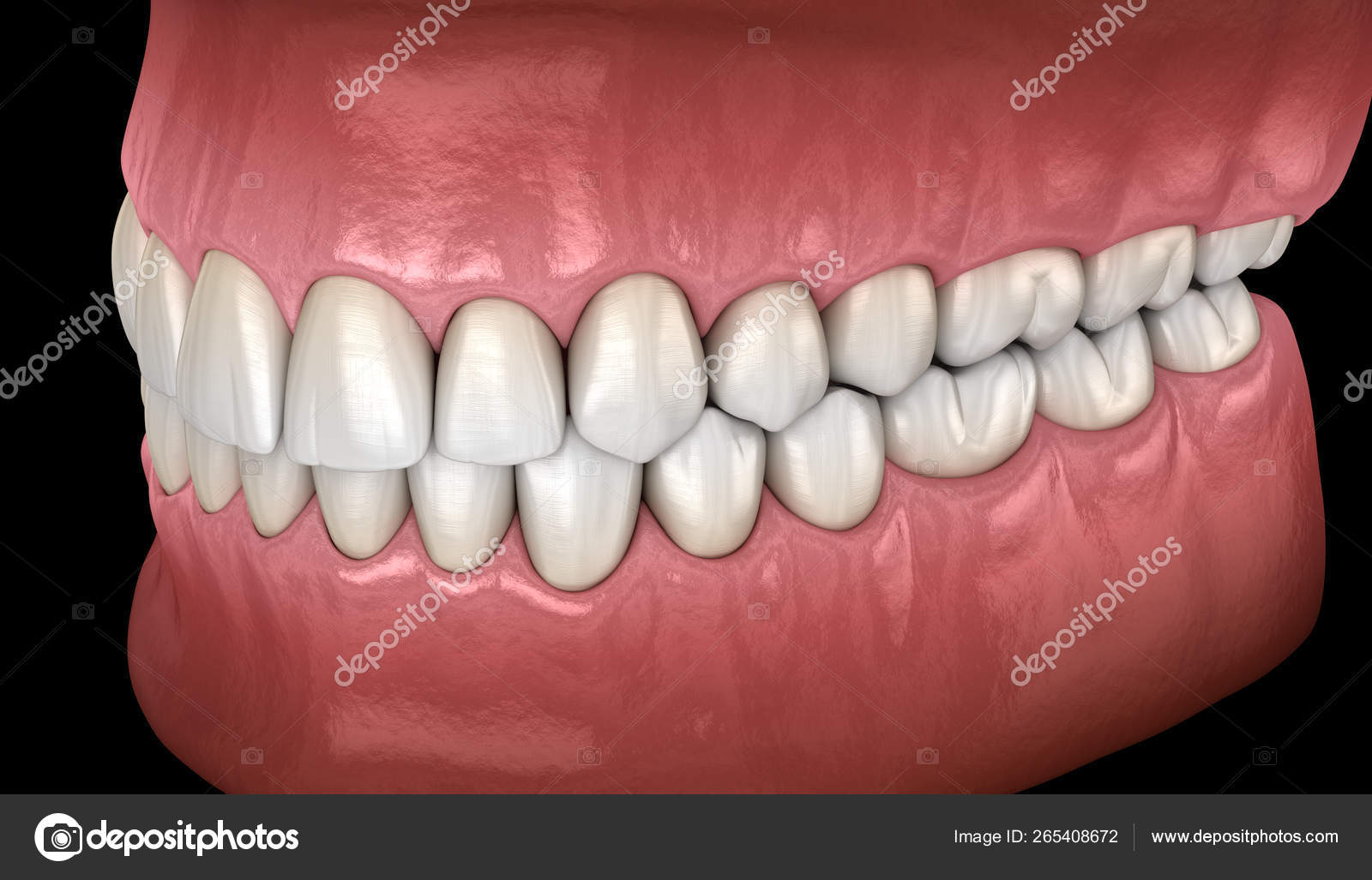 Healthy Human Teeth Normal Occlusion Side View Medically Accurate Tooth ...