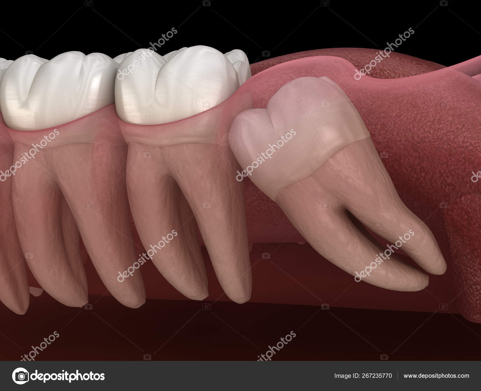 Healthy Teeth Wisdom Tooth Mesial Impaction Medically Accurate Tooth ...