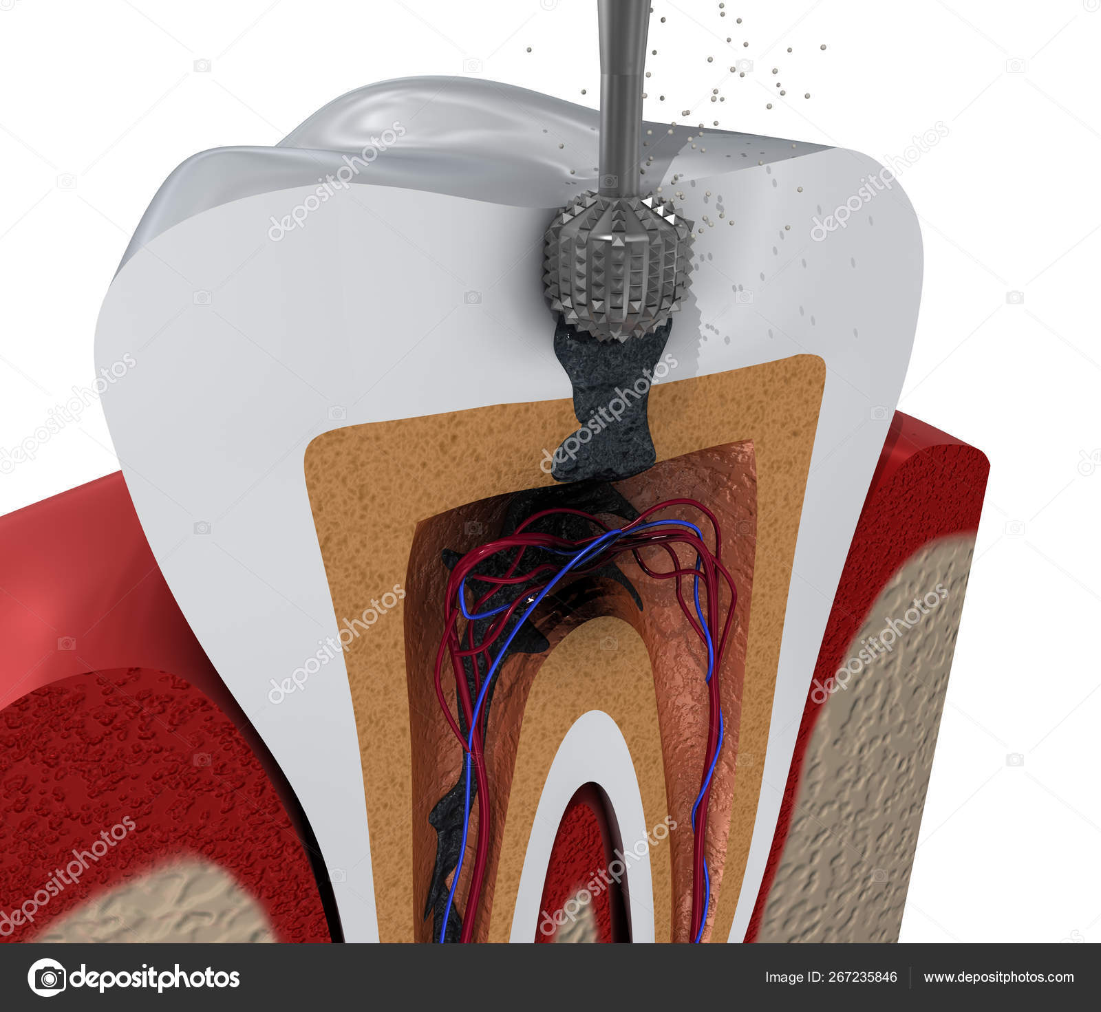 Root Canal Treatment Process Illustration — Stock Photo © Alexmit ...