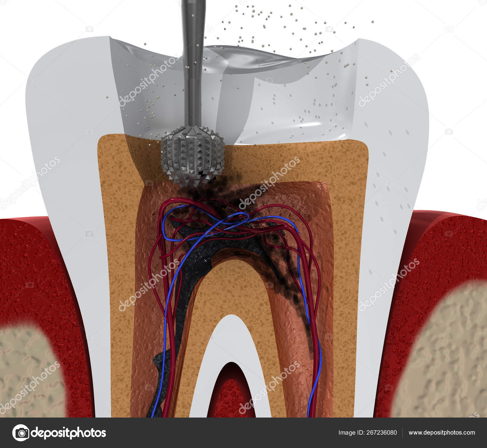 Root Canal Treatment Process Illustration — Stock Photo © Alexmit ...