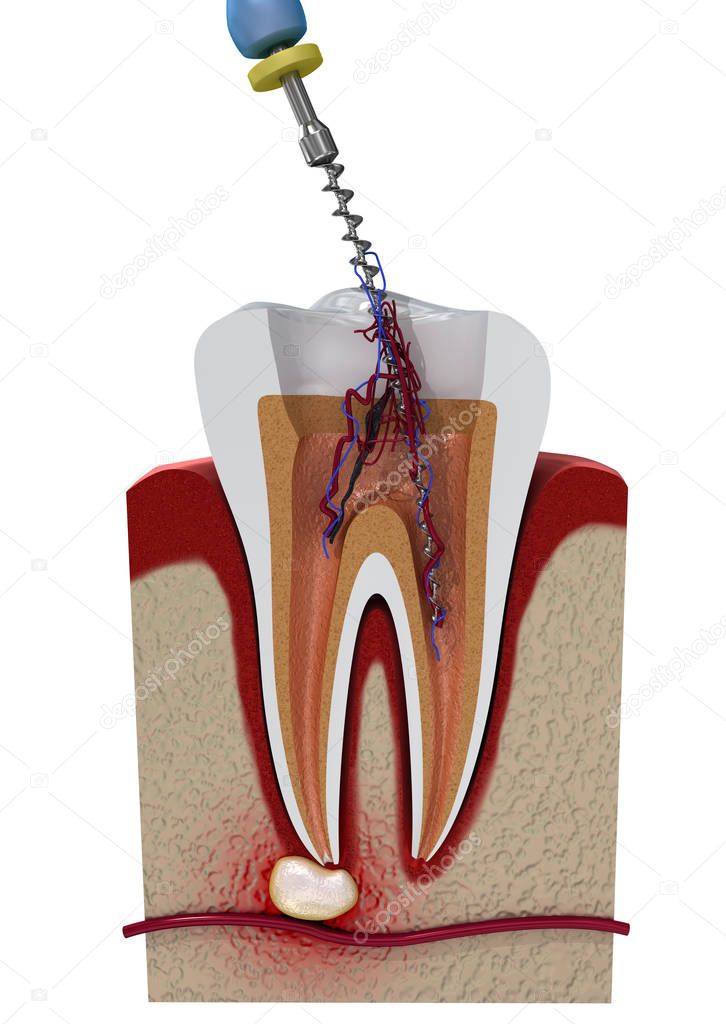 Proceso de tratamiento del canal radicular. Ilustraci n 3D 2024