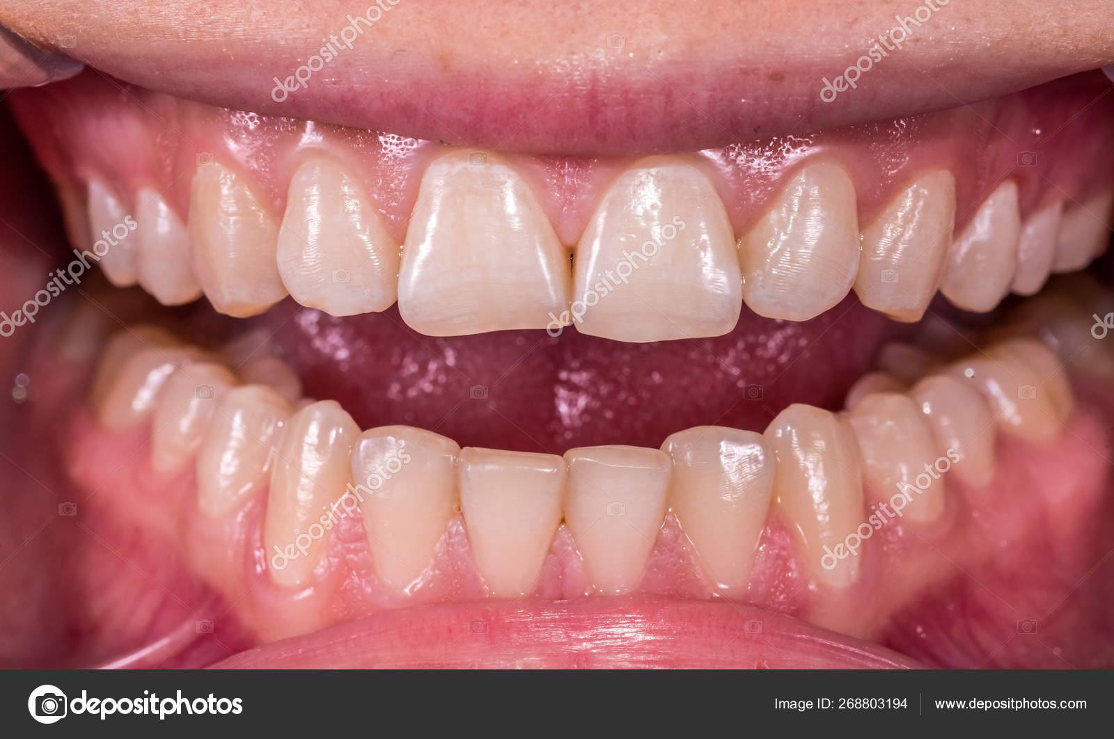 Normal Human Canine Teeth