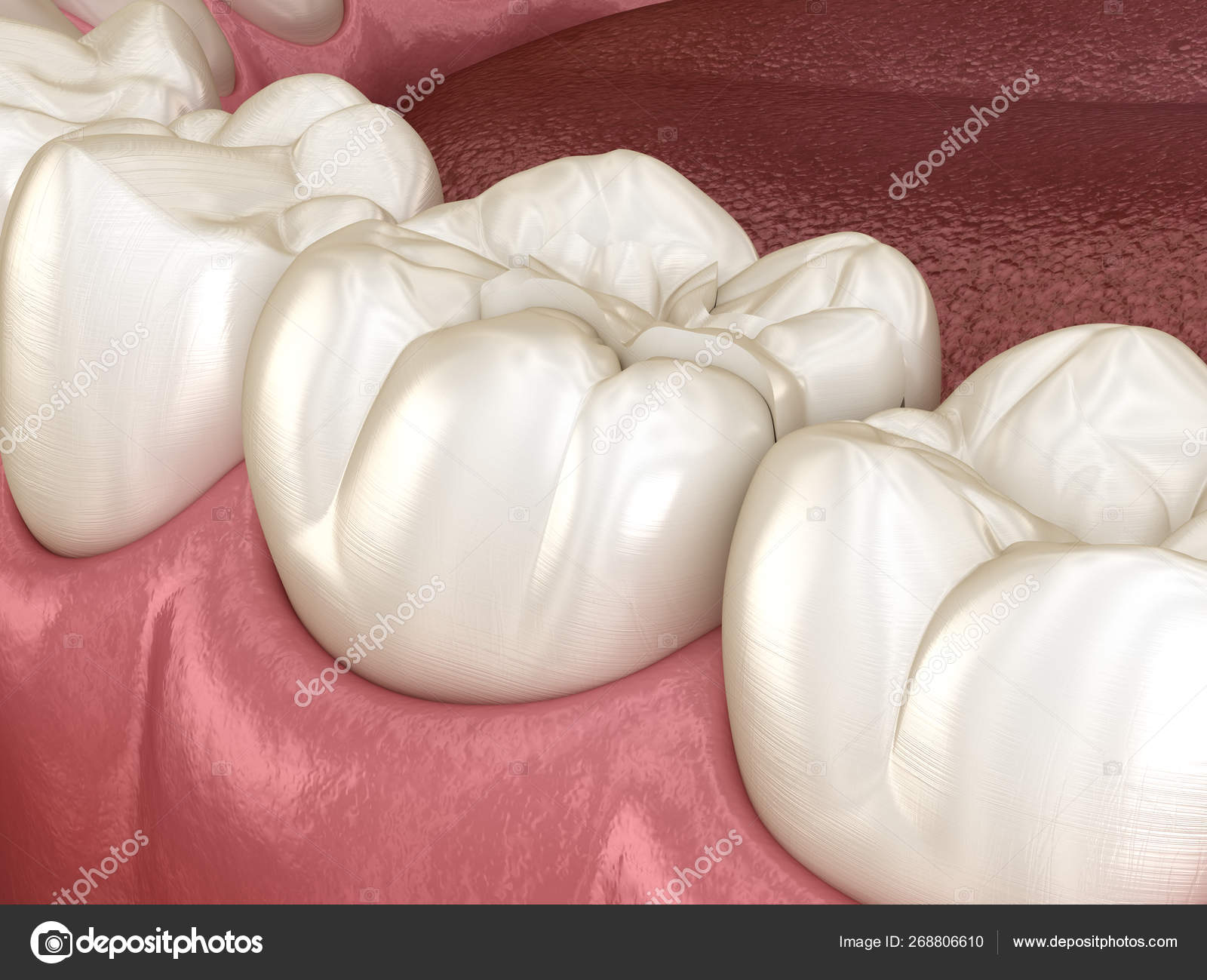 Inlay Ceramic Crown Fixation Tooth Medically Accurate Illustration ...