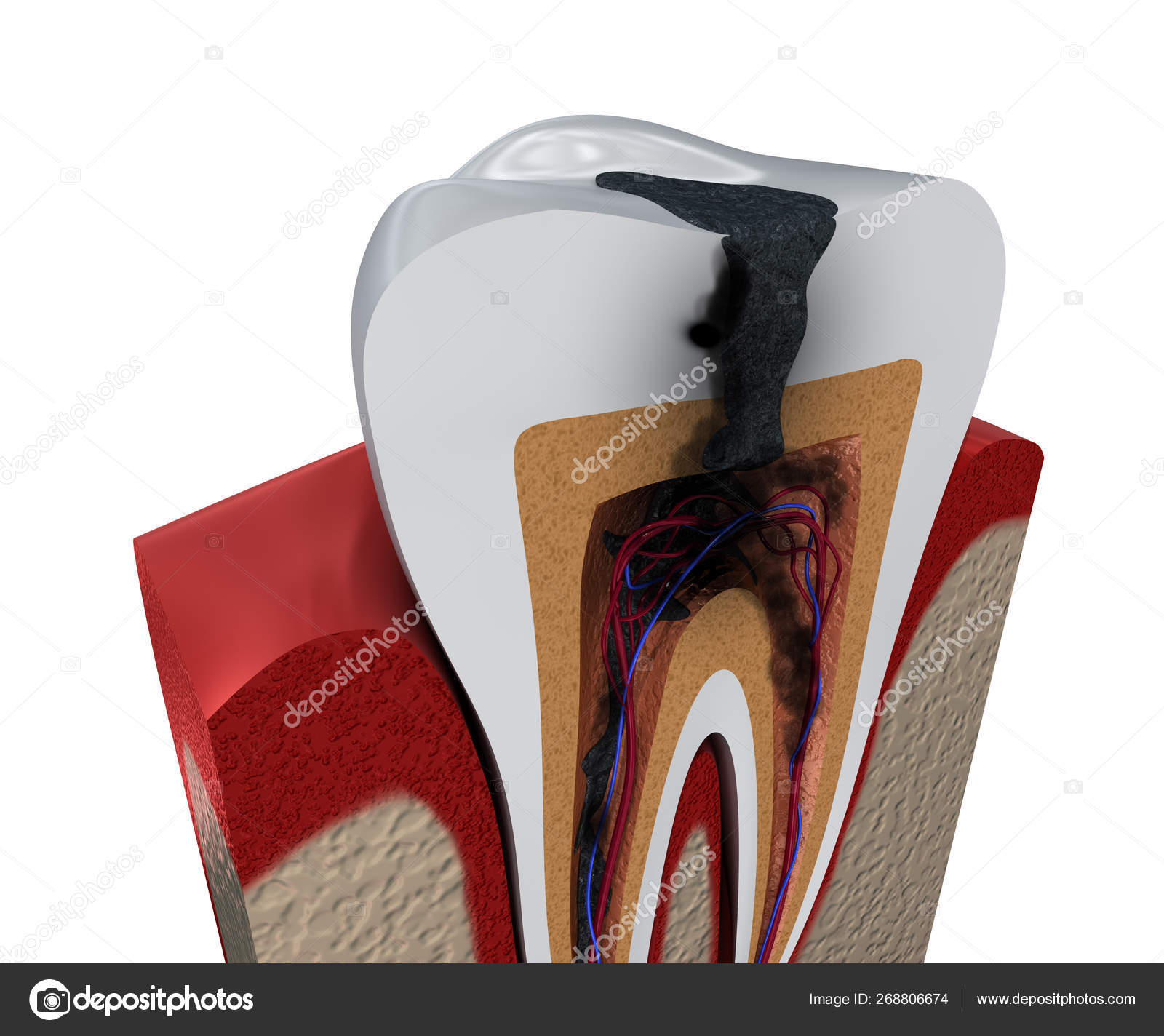 Tooth Decay Medically Accurate Tooth Illustration — Stock Photo ...
