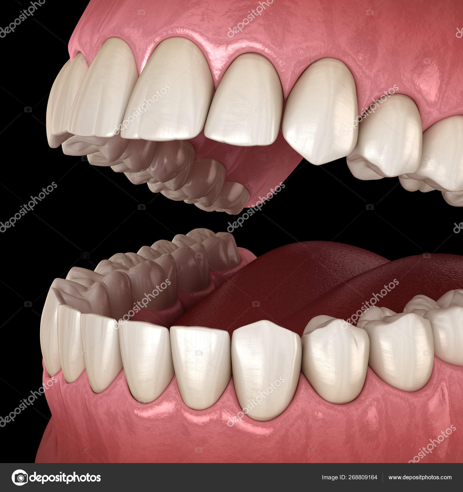 Dental Anatomy Opened Dentures Medically Accurate Dental Illustration ...