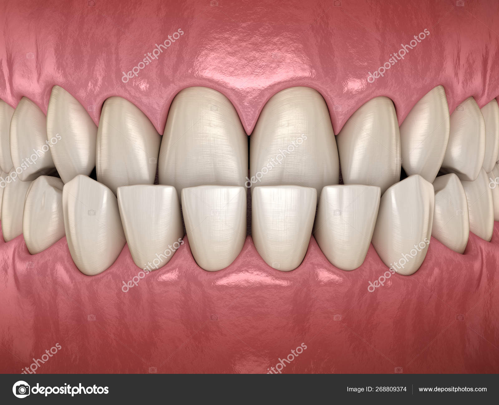 Underbite Dental Occlusion Malocclusion Teeth Medically Accurate Tooth ...