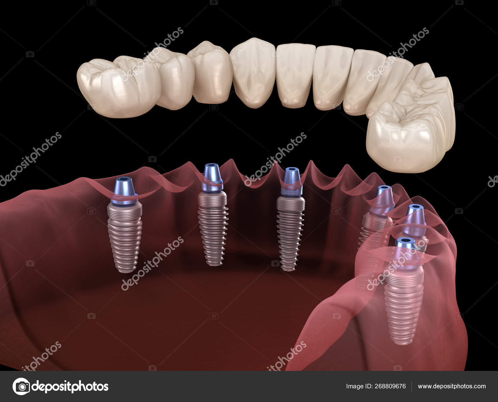 Mandibular Prosthesis All System Supported Implants Medically Accurate ...