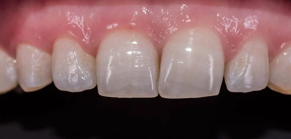What Happens To Teeth Under Veneers: Learn the Long-Term Effects