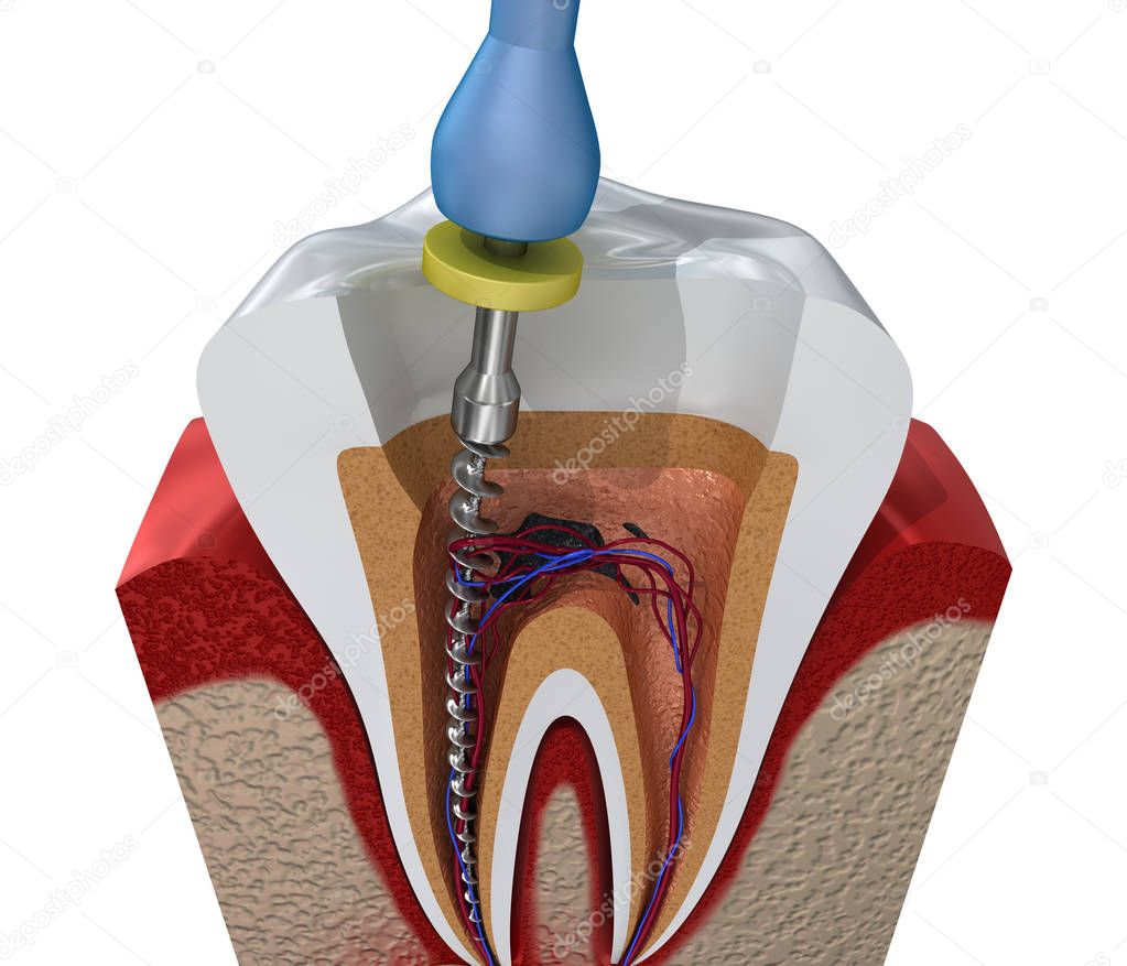 Proceso de tratamiento del canal radicular. Ilustración 3D 2022