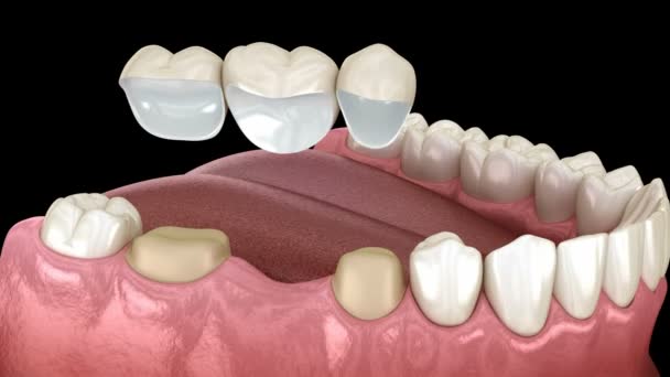 Dental bridge of 3 teeth over molar and premolar. Medically accurate 3D ...