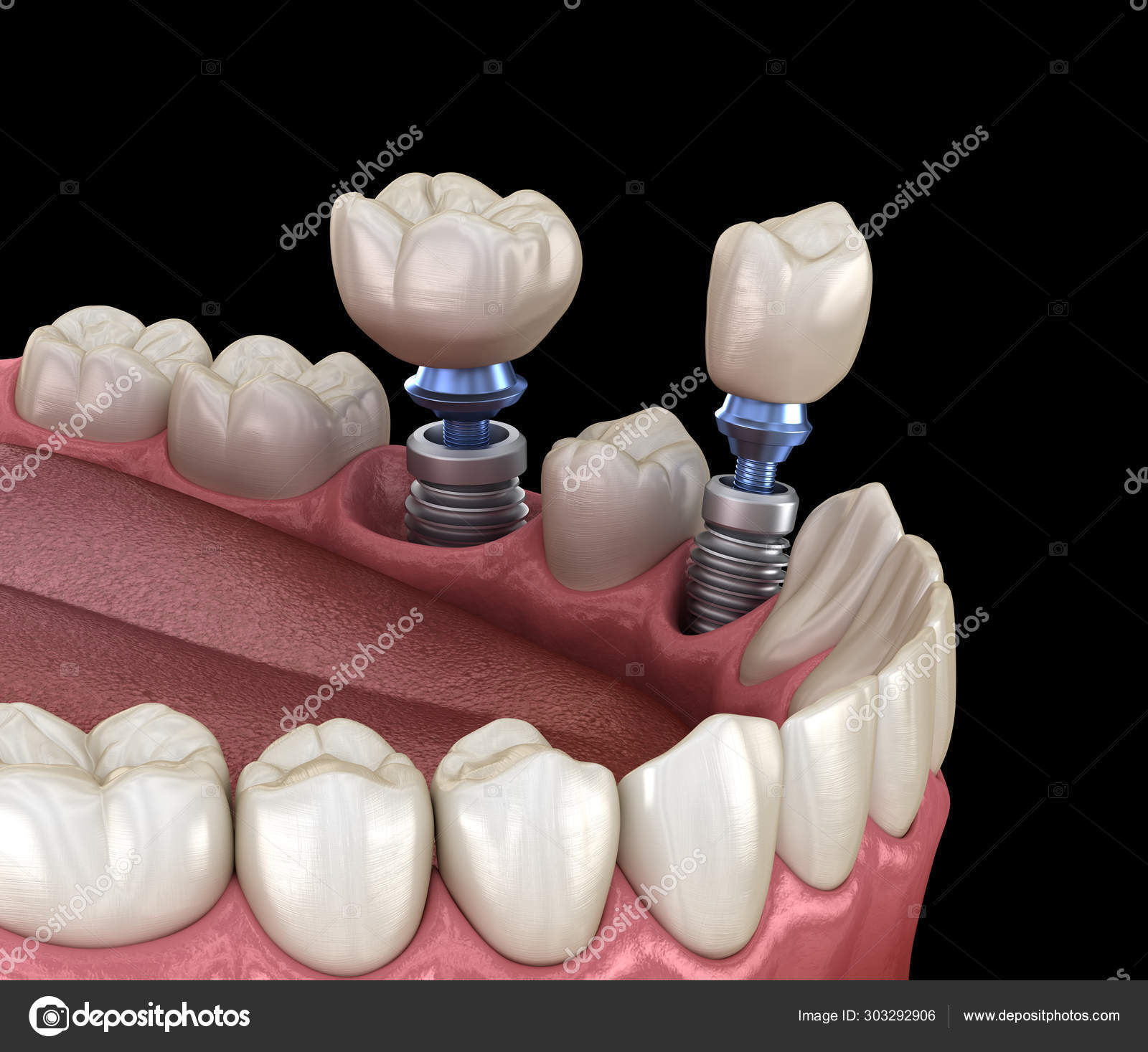 Premolar Molar Tooth Crown Installation Implant Abutments Medically ...