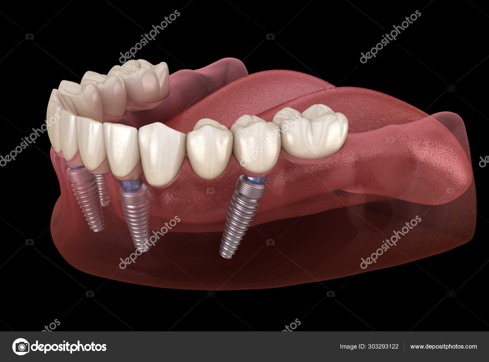 Mandibular Prosthesis All System Supported Implants Medically Accurate ...