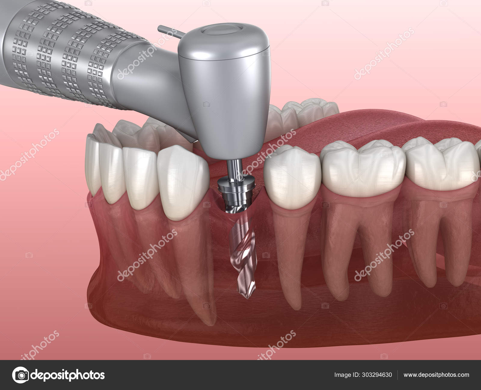 Dental Drill Tooth