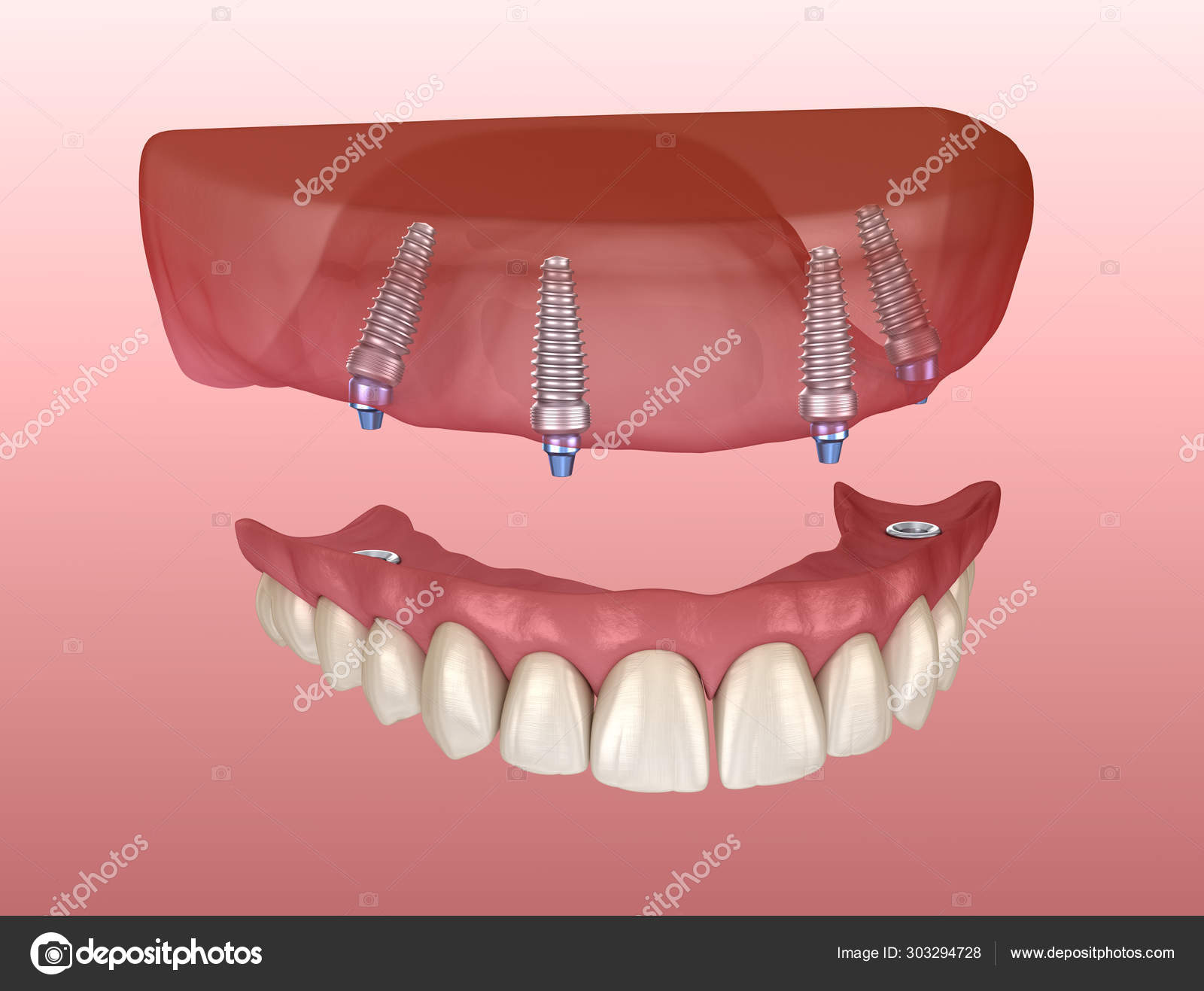 Maxillary Prosthesis Gum All System Supported Implants Medically ...