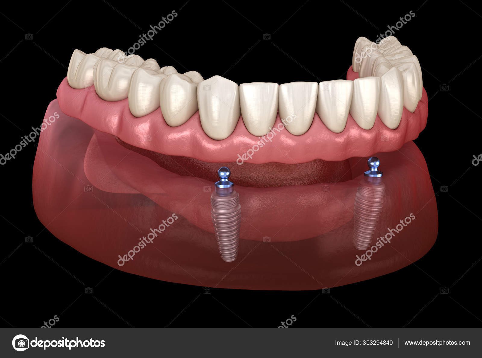 Mandibular Removable Prosthesis All System Supported Implants Ball ...