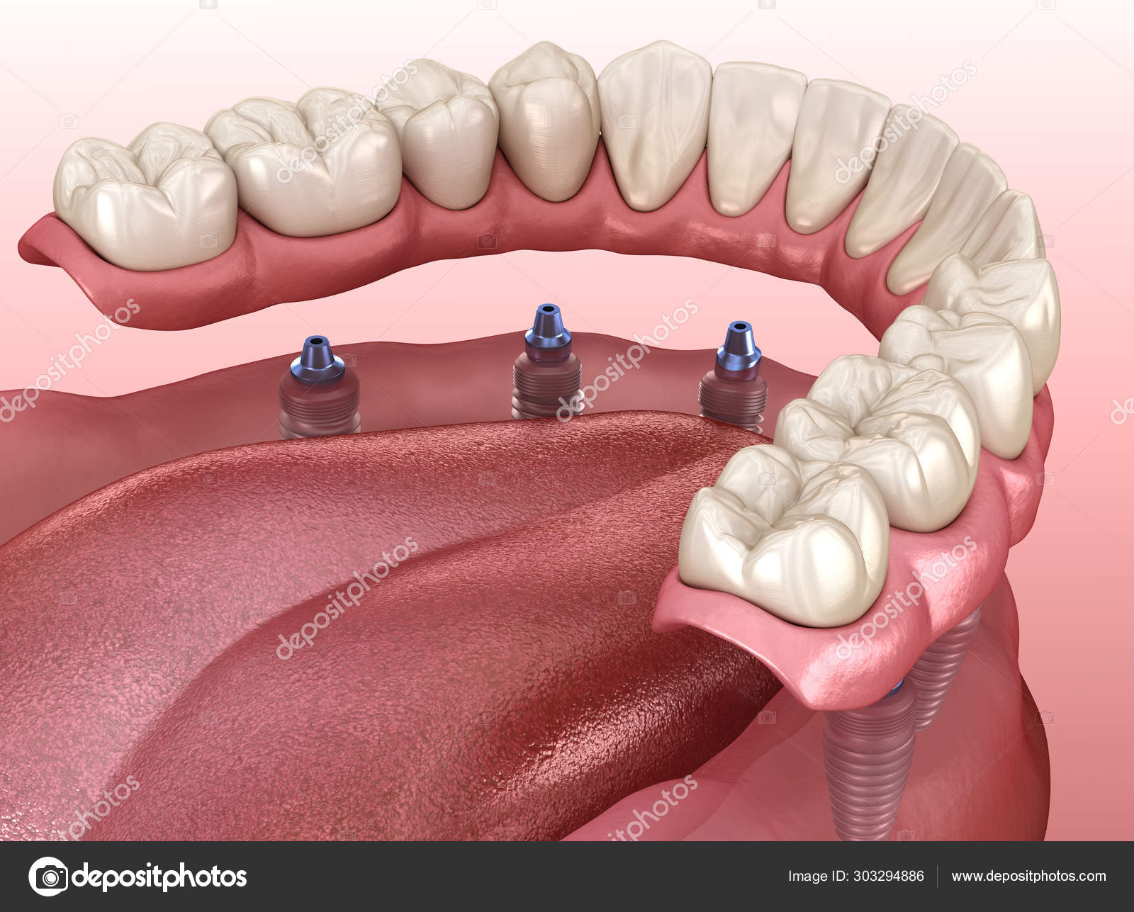 Mandibular Prosthesis Gum All System Supported Implants Medically ...