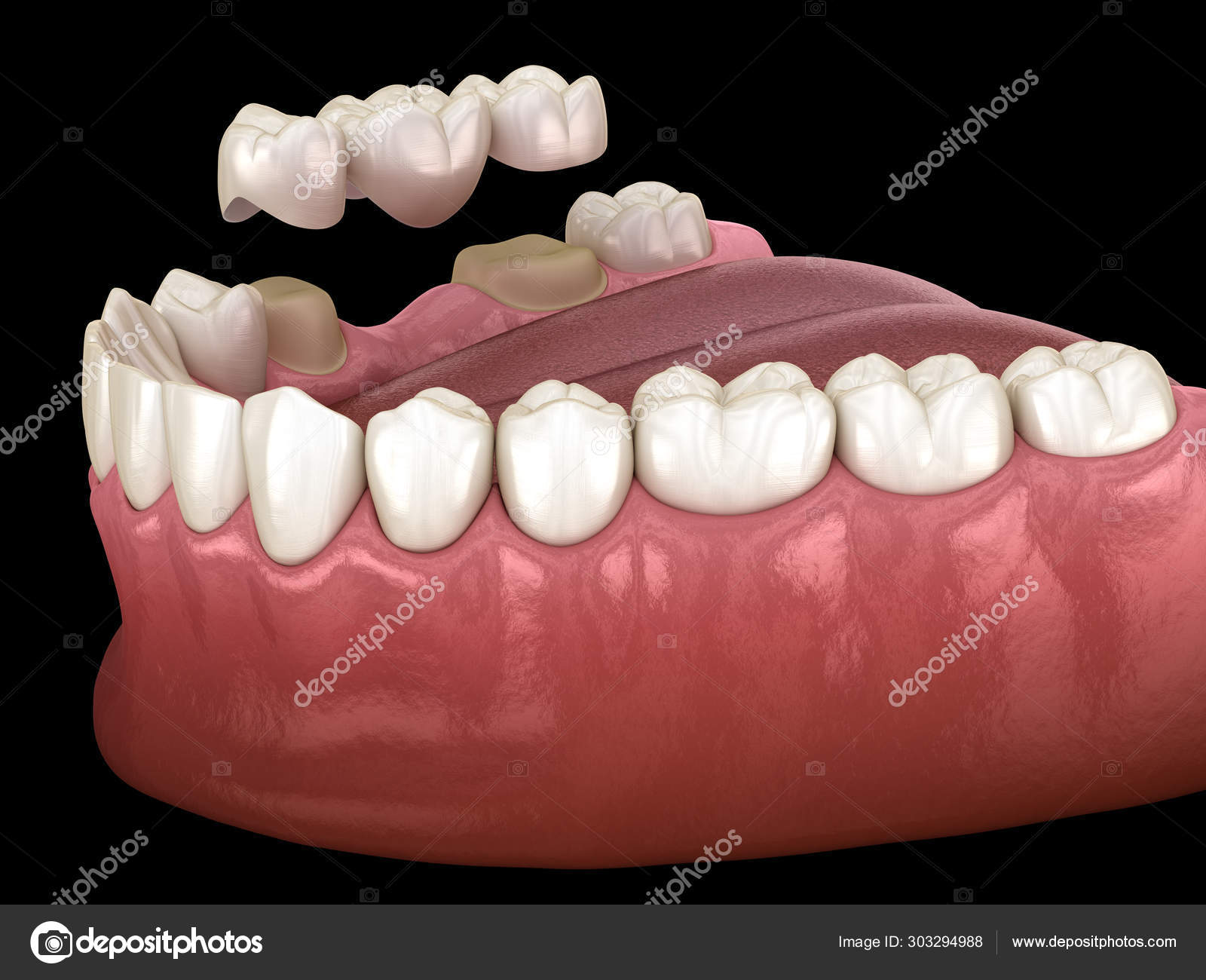 Dental Bridge Teeth Molar Premolar Medically Accurate Illustration ...