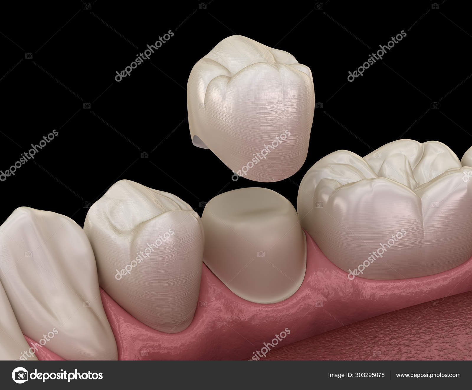 Preparated Premolar Tooth Dental Crown Placement Medically Accurate ...