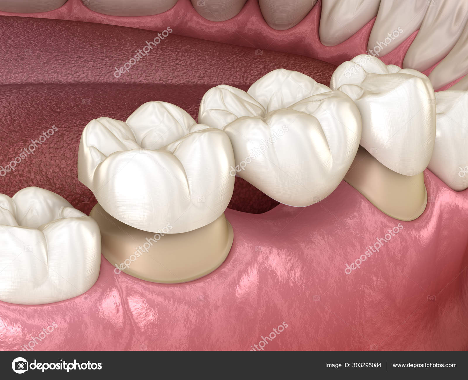 Dental Bridge Teeth Molar Premolar Medically Accurate Illustration ...