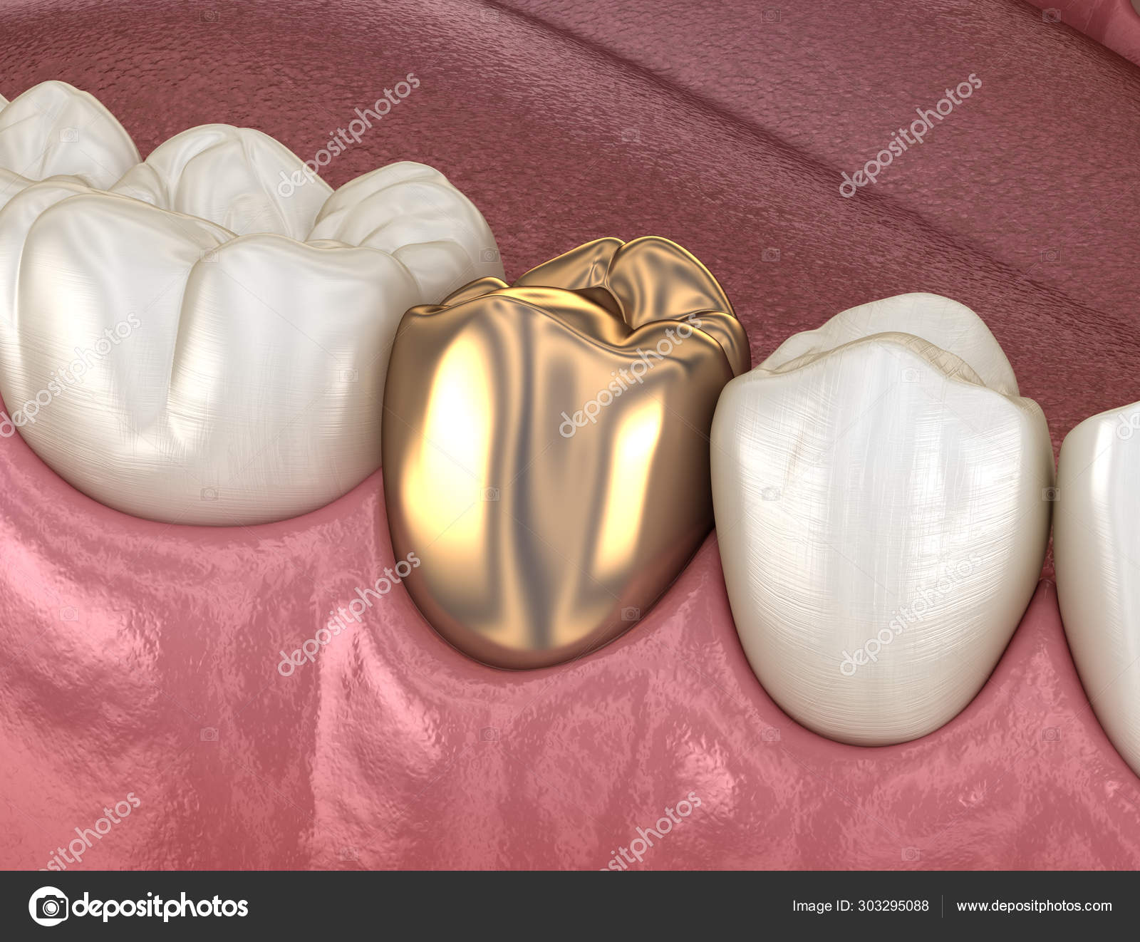 Golden Crown Premolar Tooth Assembly Process Medically Accurate ...