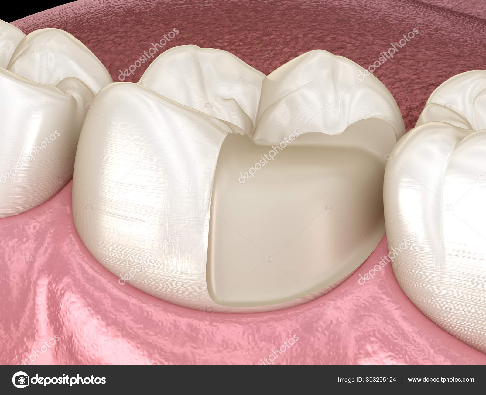 Onlay Ceramic Crown Fixation Tooth Medically Accurate Illustration ...