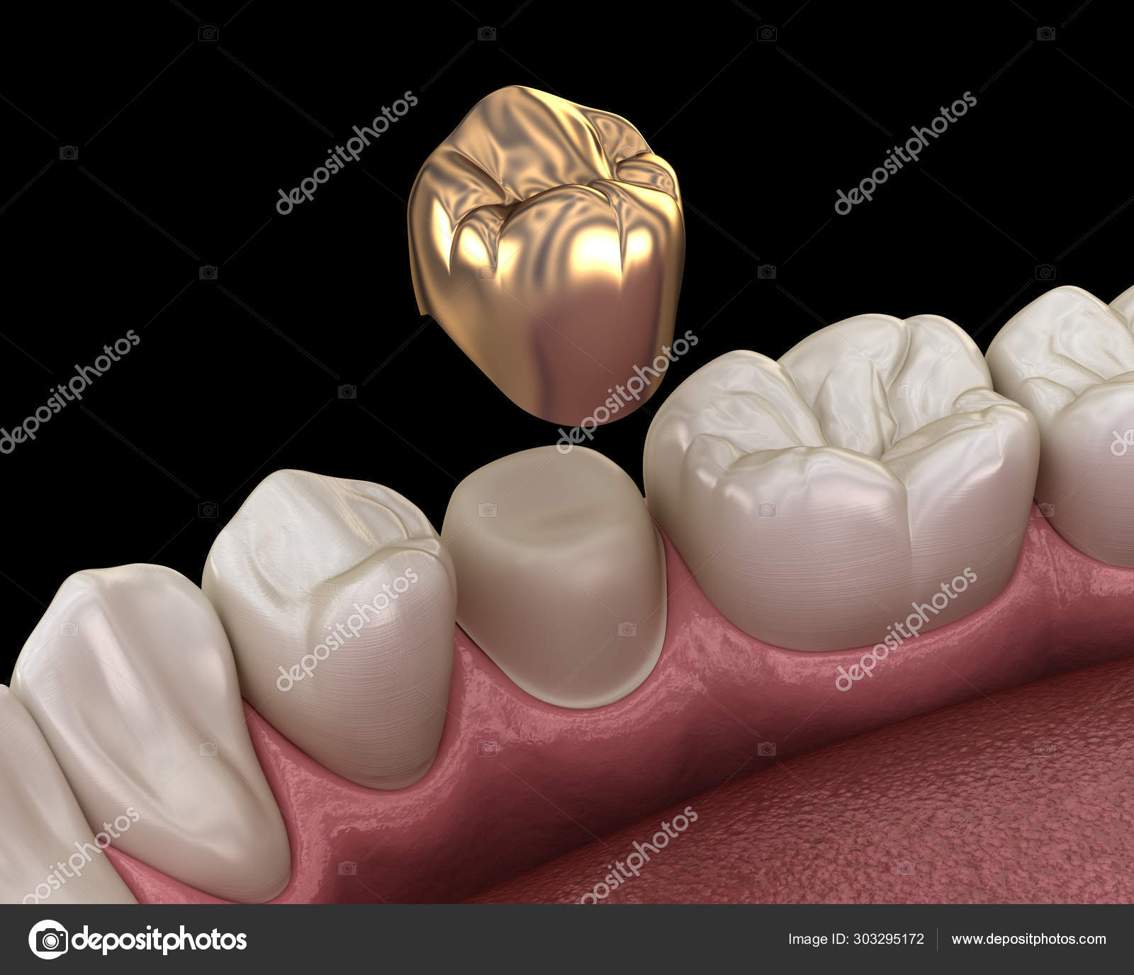 Golden Crown Premolar Tooth Assembly Process Medically Accurate ...