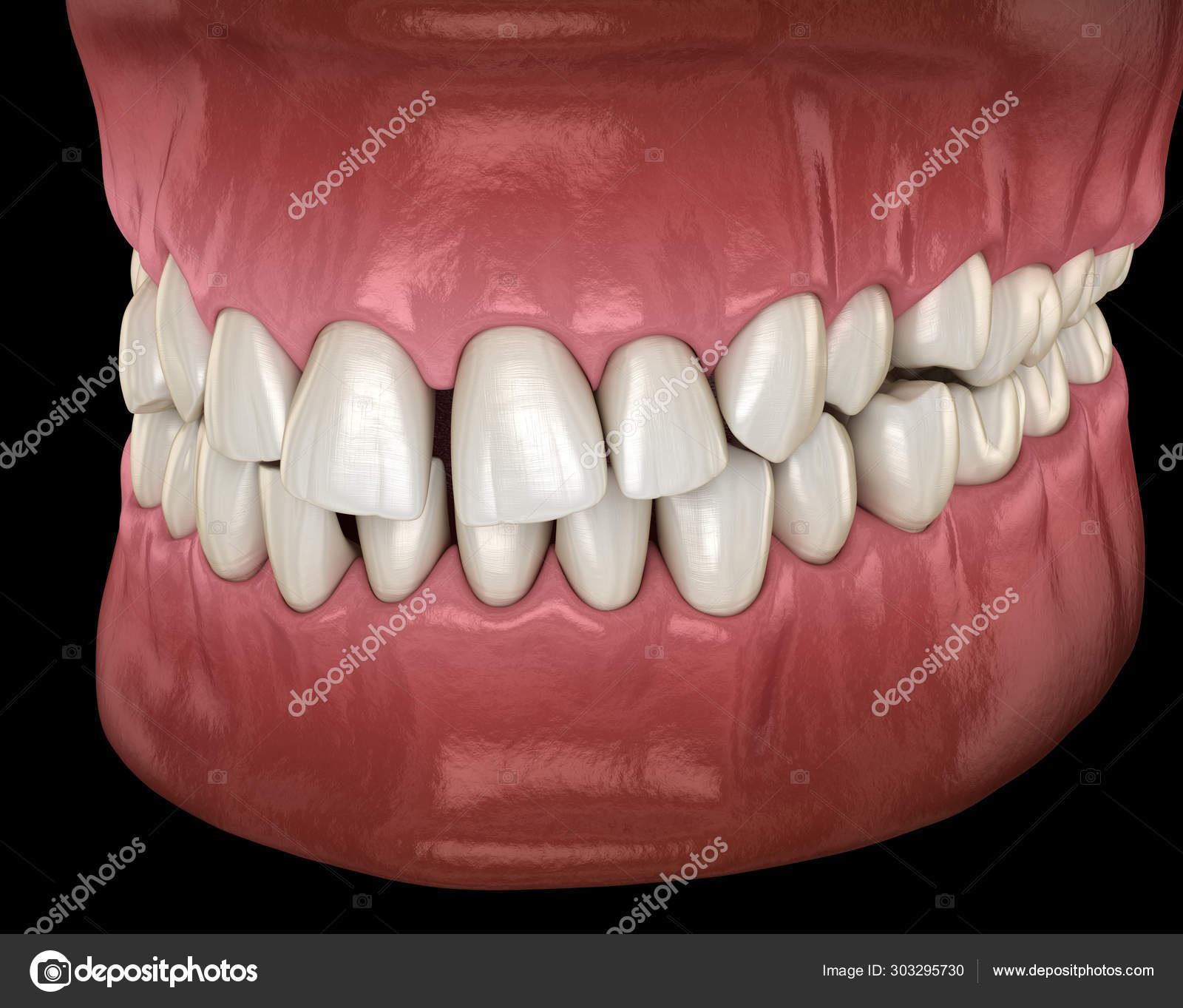 Healthy Human Teeth Normal Occlusion Side View Medically Accurate Tooth ...