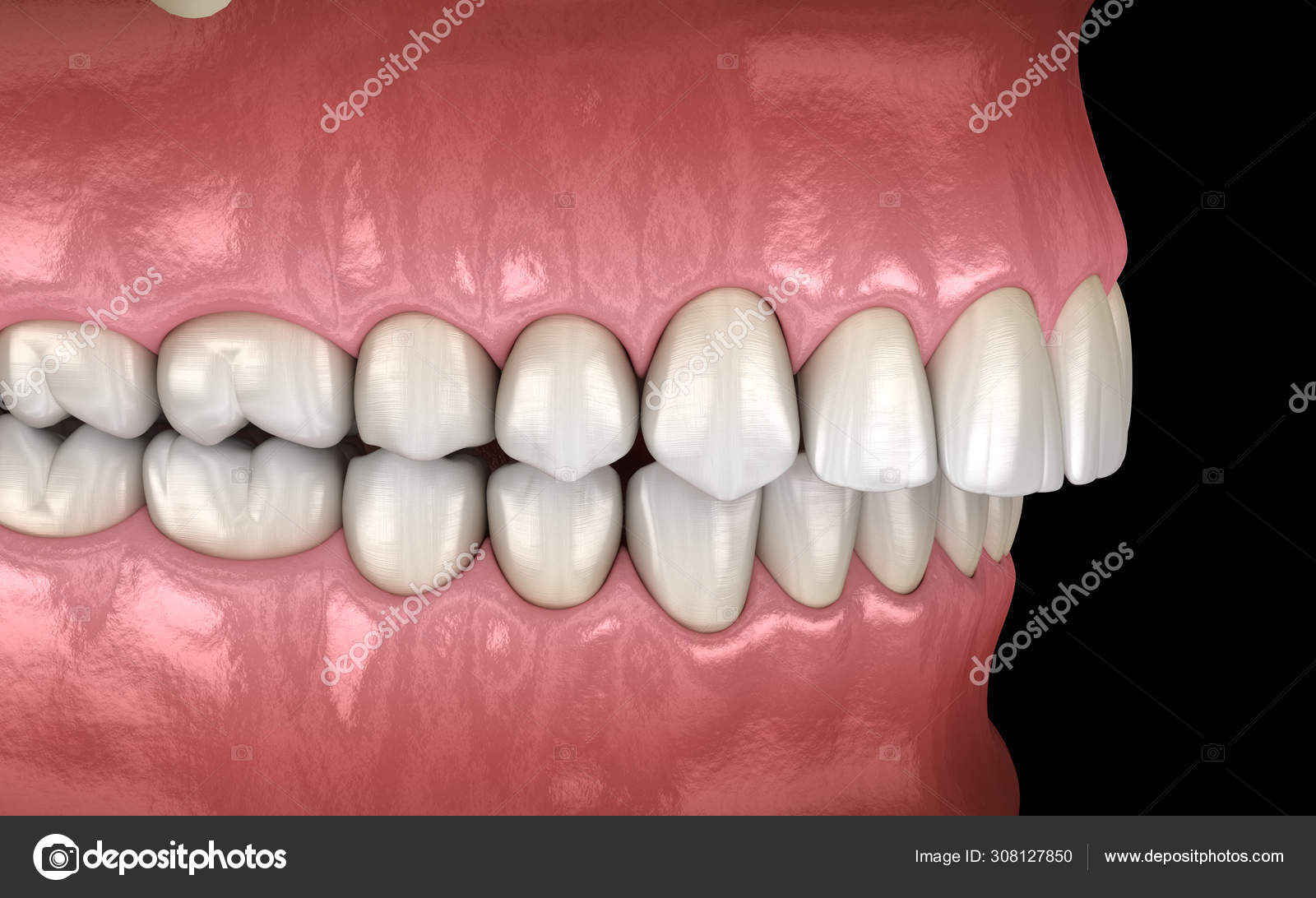 Overbite Dental Occlusion Malocclusion Teeth Medically Accurate Tooth ...