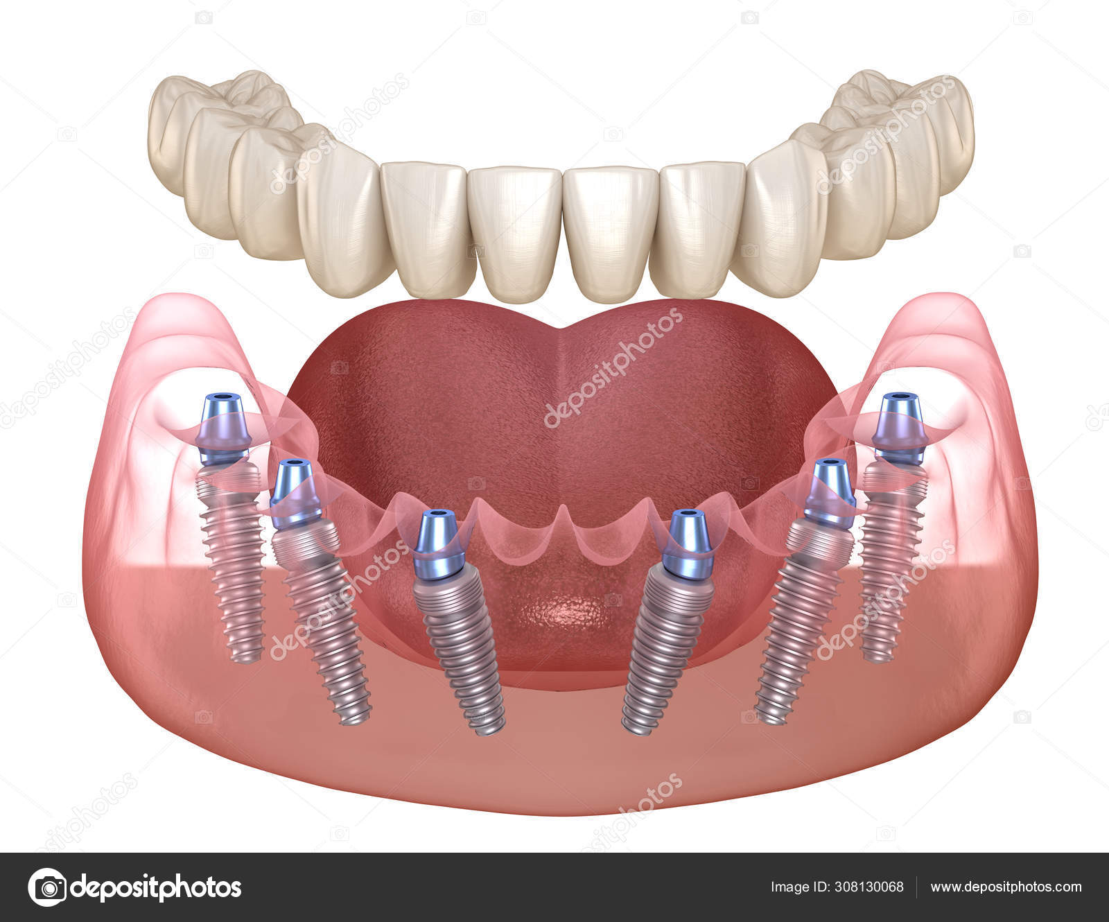 Mandibular Prosthesis All System Supported Implants Medically Accurate ...